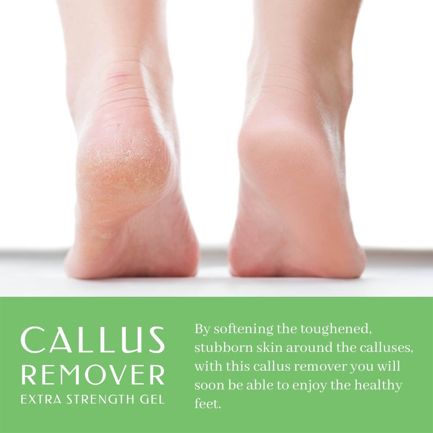 Extra-Strength Bella Feet Callus Remover Kit with Scrubber, Gloves ...