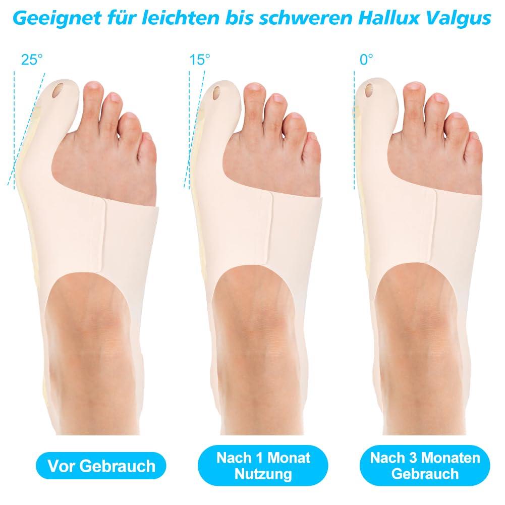 Soarfly Hallux Valgus Correction | Adjustable Bandage & Non-Slip Heel ...