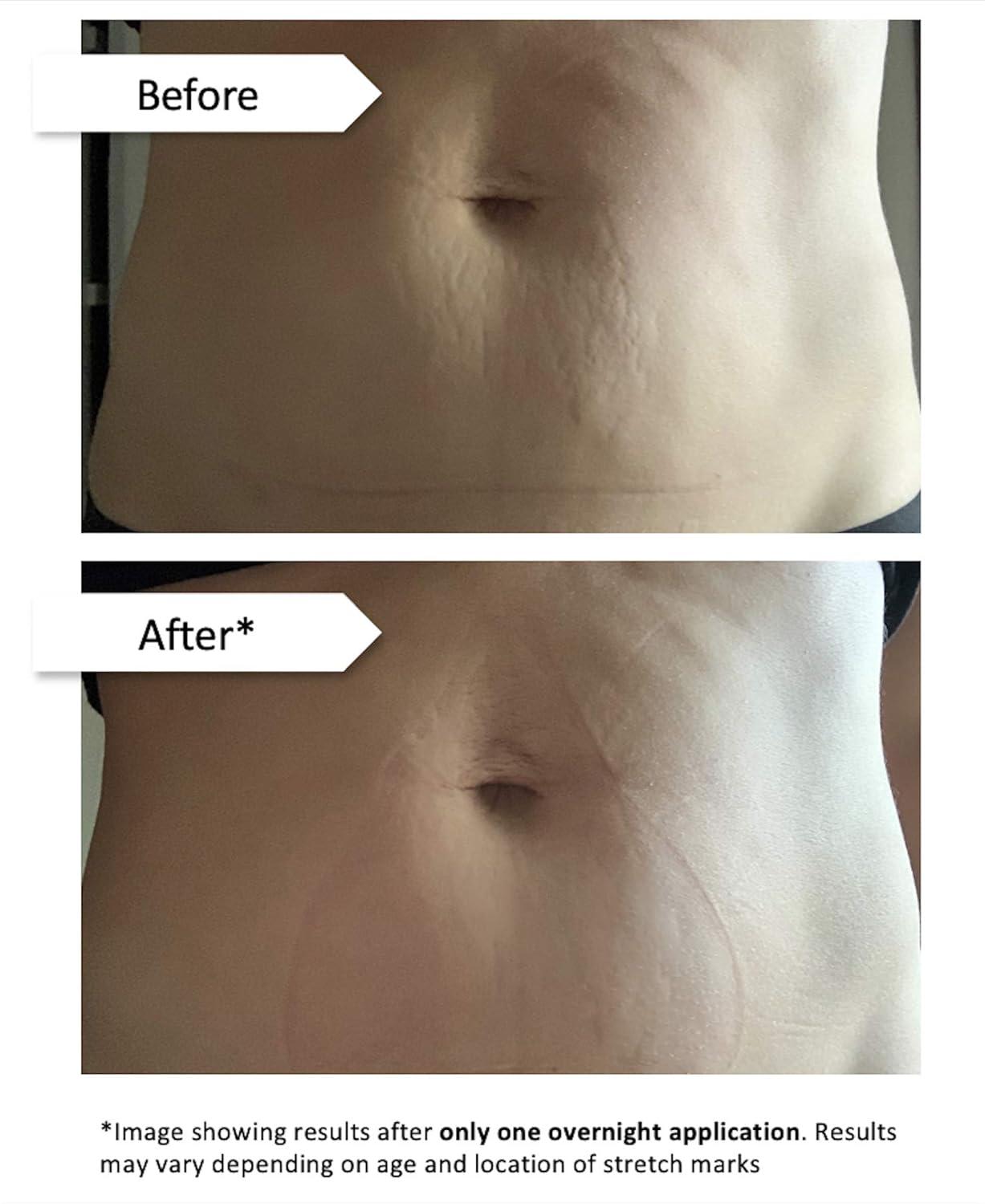 Stretch Mark Eraser | Overnight Treatment for Stretch Marks | 1 Patch ...