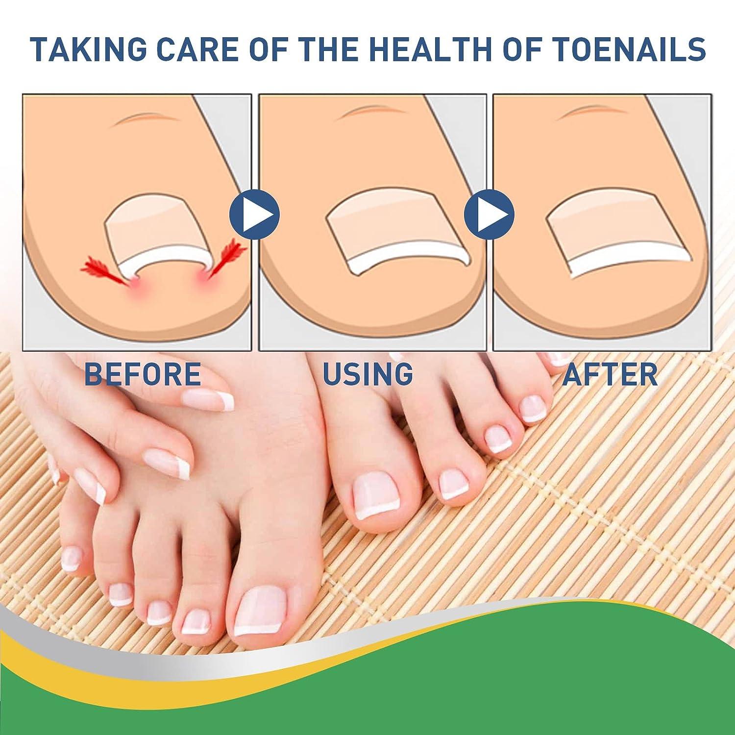 Fitmedify Nail Patches - Toenail Correction Tool for Ingrown Nails ...