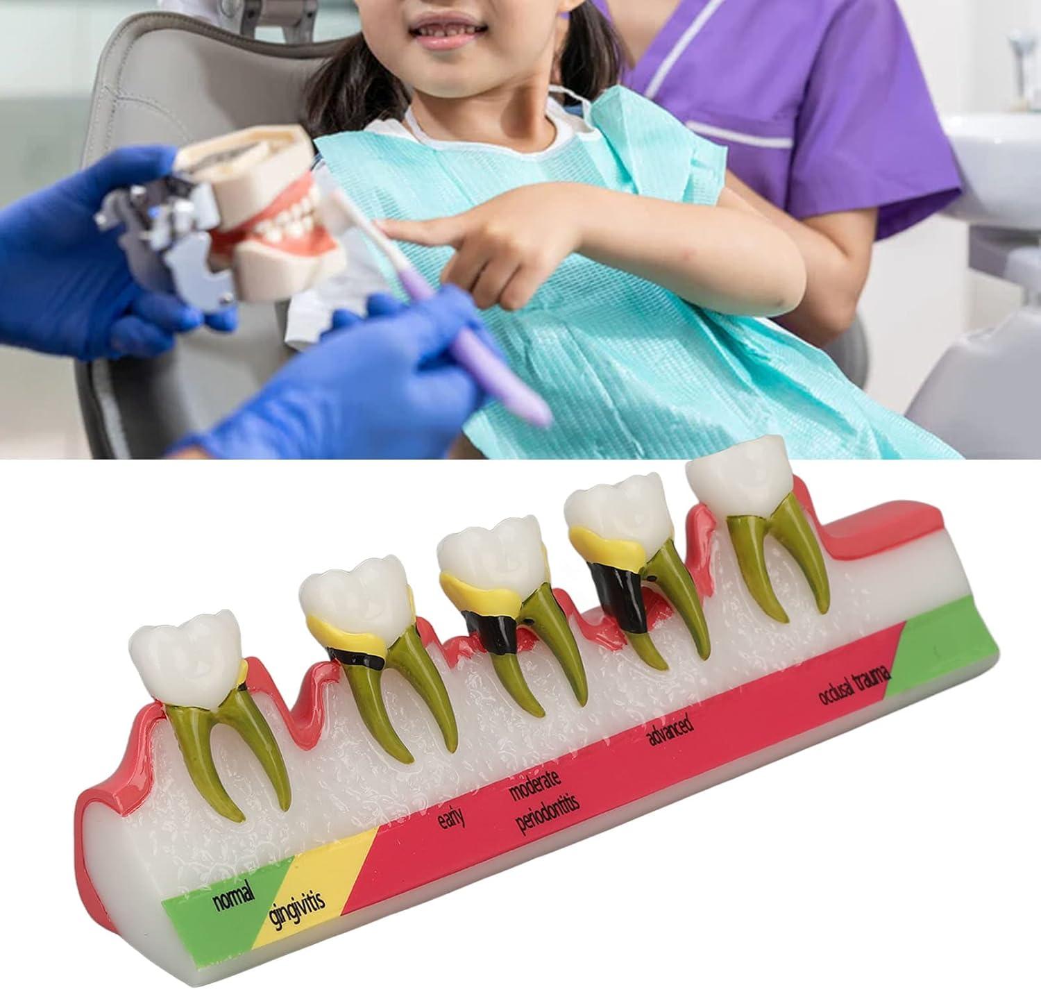 Dental Model for Periodontitis - Realistic Teaching Aid Resin Model for ...
