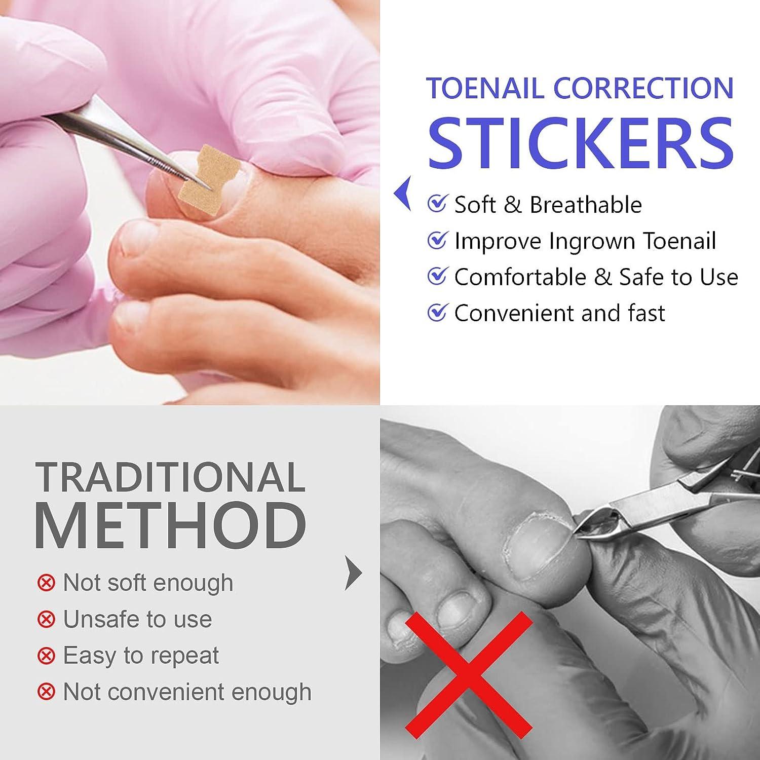 100PCS Ingrown Toenail Corrector Strips - Painless Toenail Correction ...