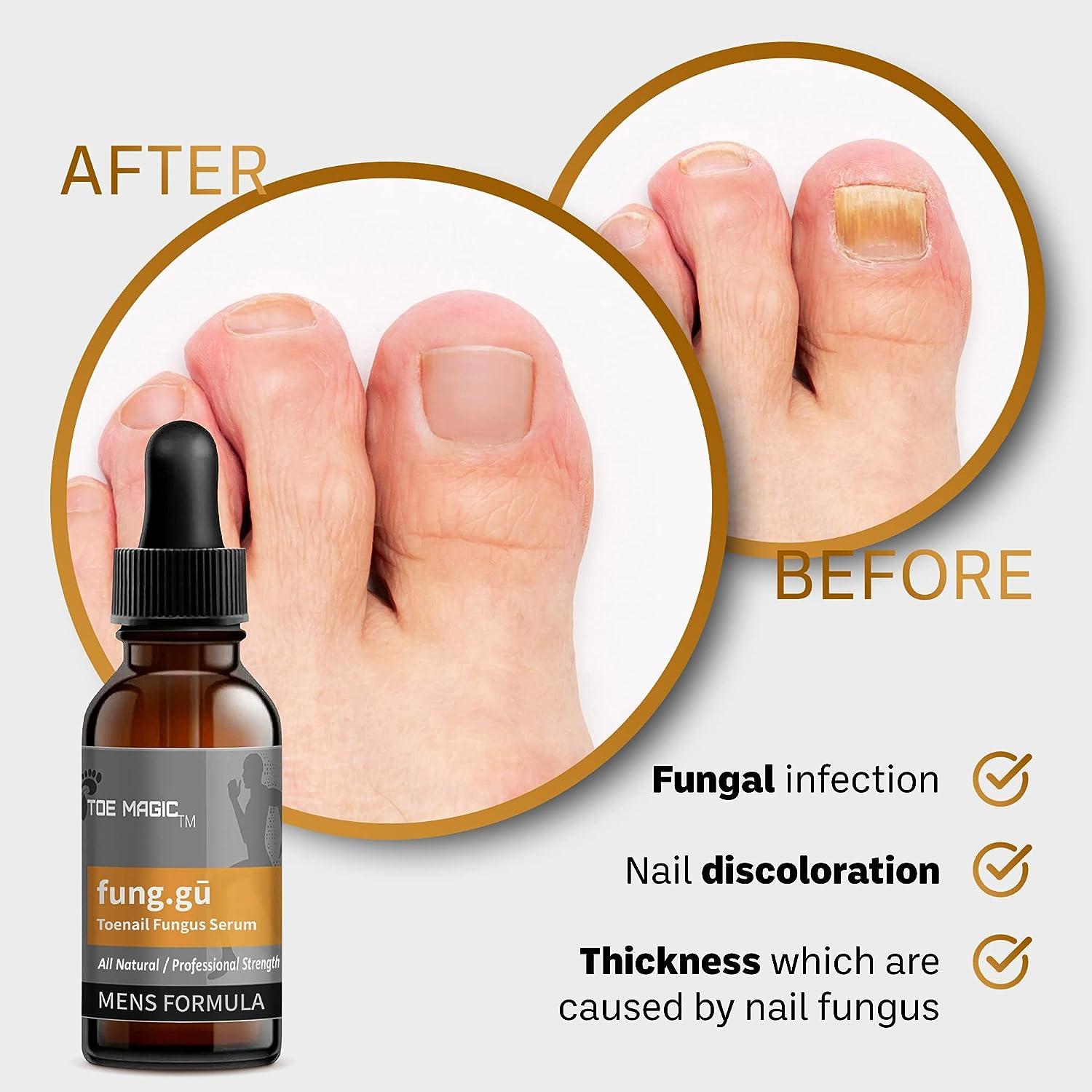 Toe Magic Men's Toenail Fungus Serum | Repair & Renew Damaged Nails ...