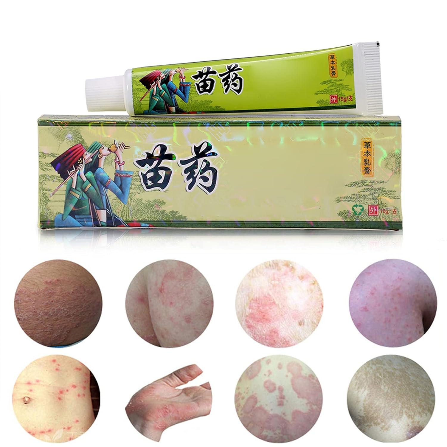 Traditional ANGGREK Skin Cream - Solving Common Skin Problems | Buy Now ...