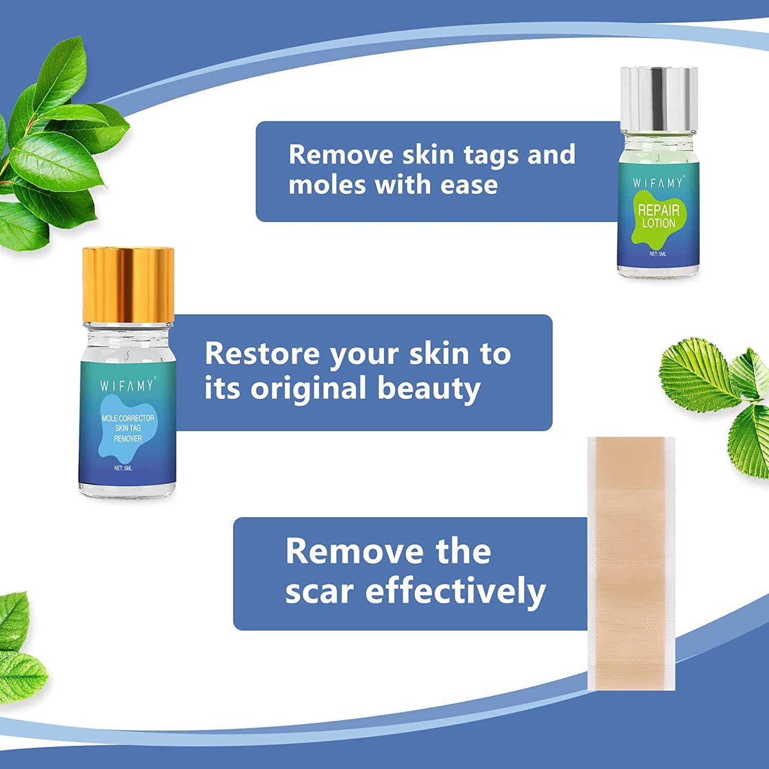 Skin Tag & Mole Remover Kit - Remove Without Scars | Skin Tag Removal ...