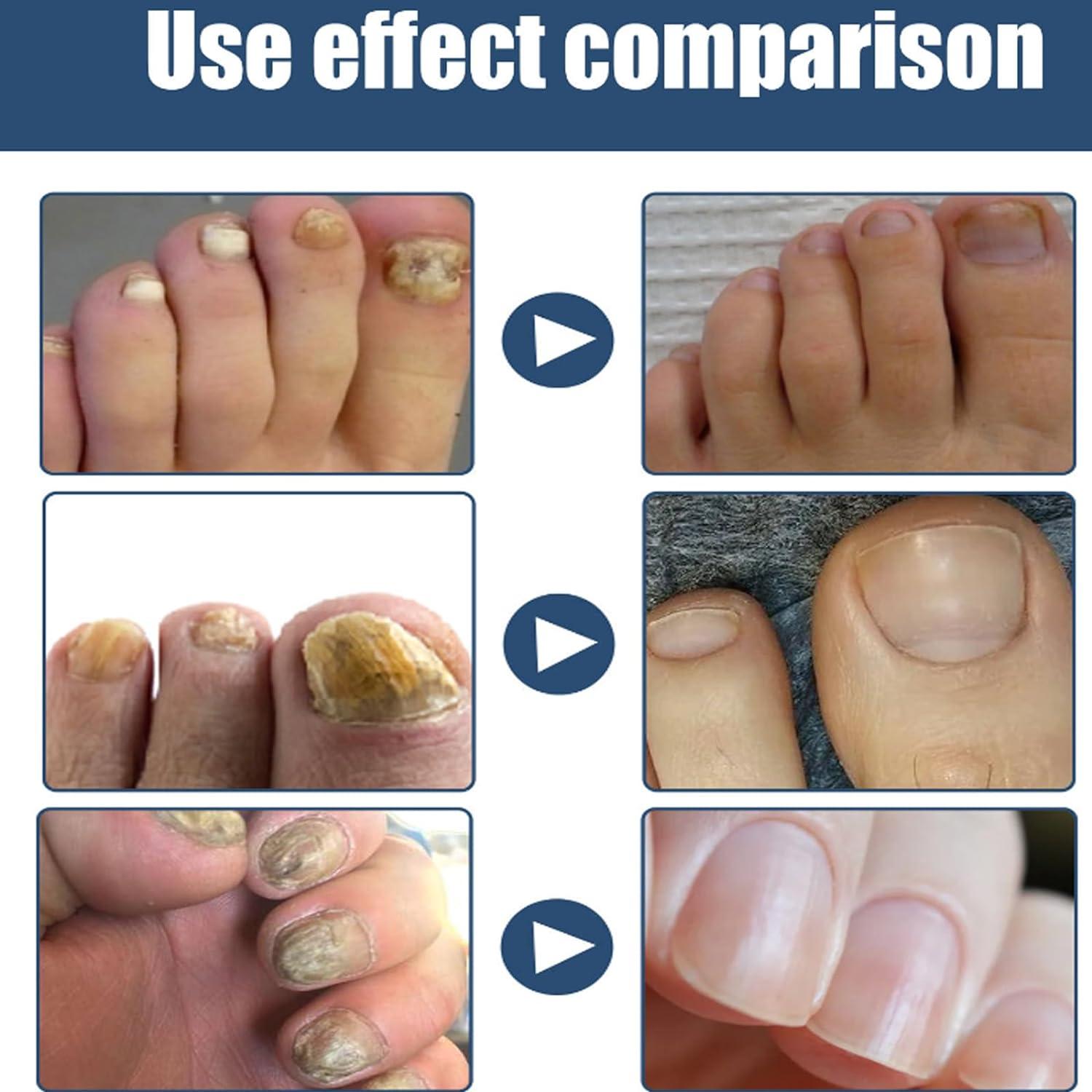 Furzero Nail Fungus & Athletes Foot Treatment Spray - 5PCS - Relieves ...