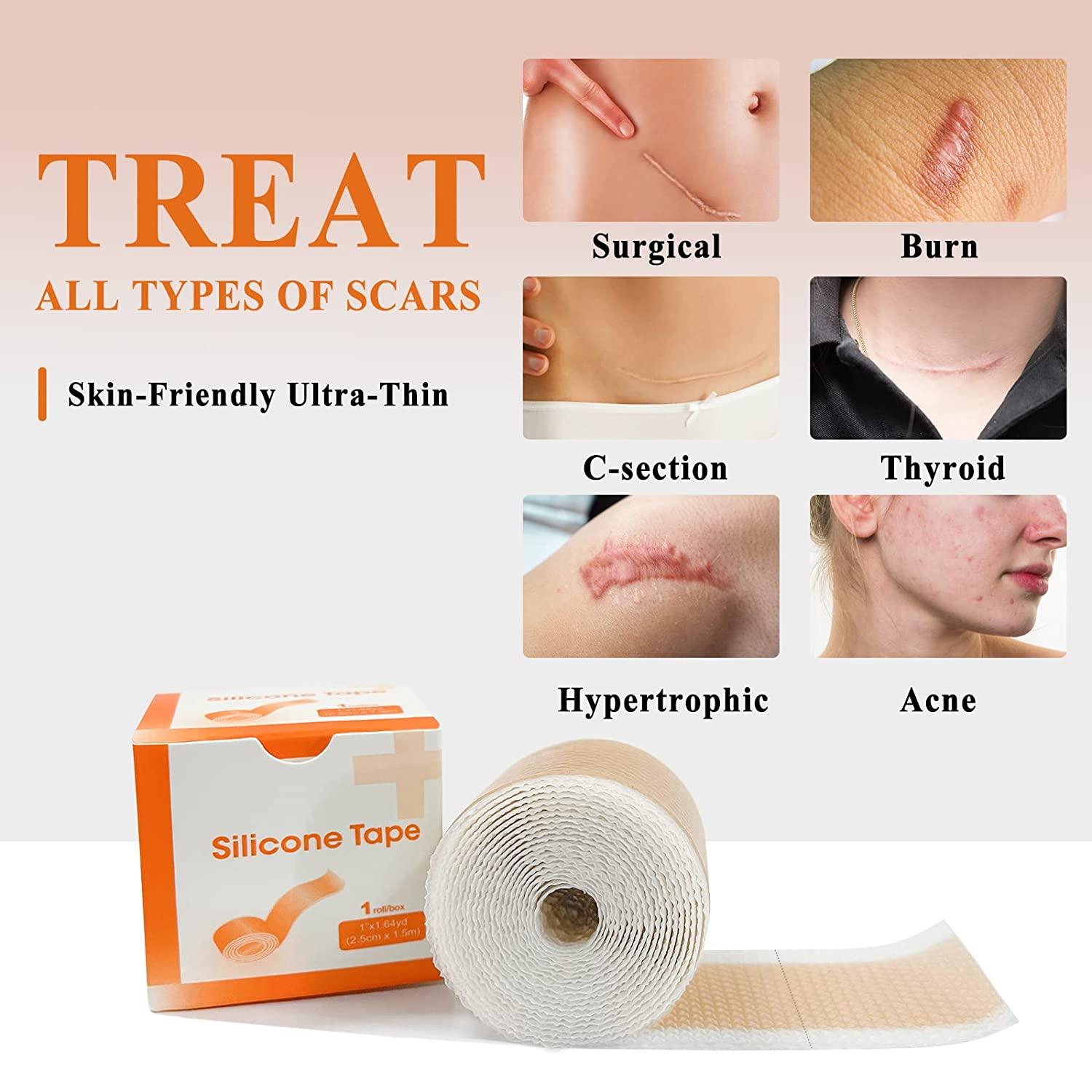 Silicone Scar Tape 1x60 Roll - Painless Medical Tape for Scar Removal ...