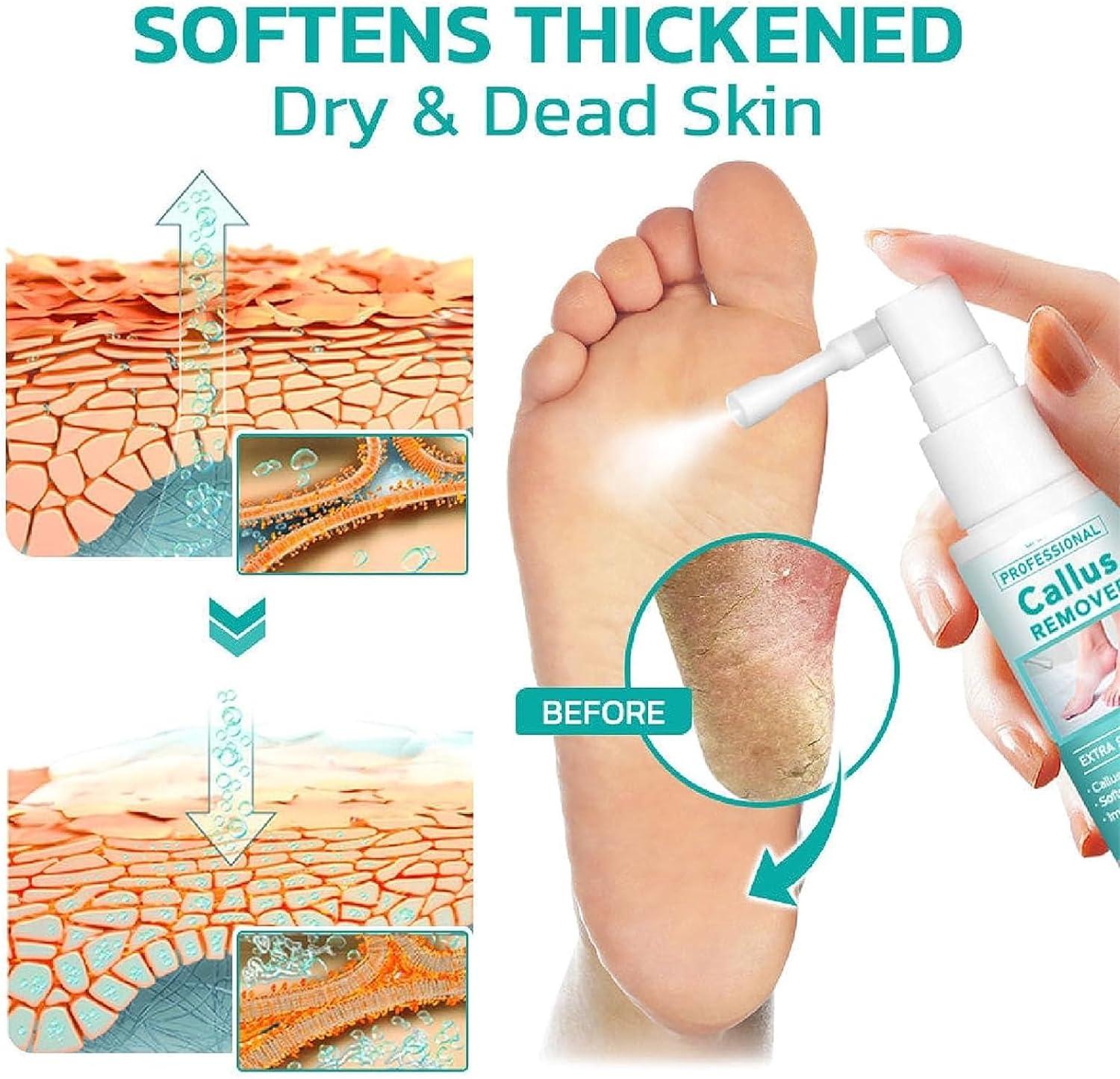 Professional Callus Remover Extra Strength Spray Foot Callus Removal ...