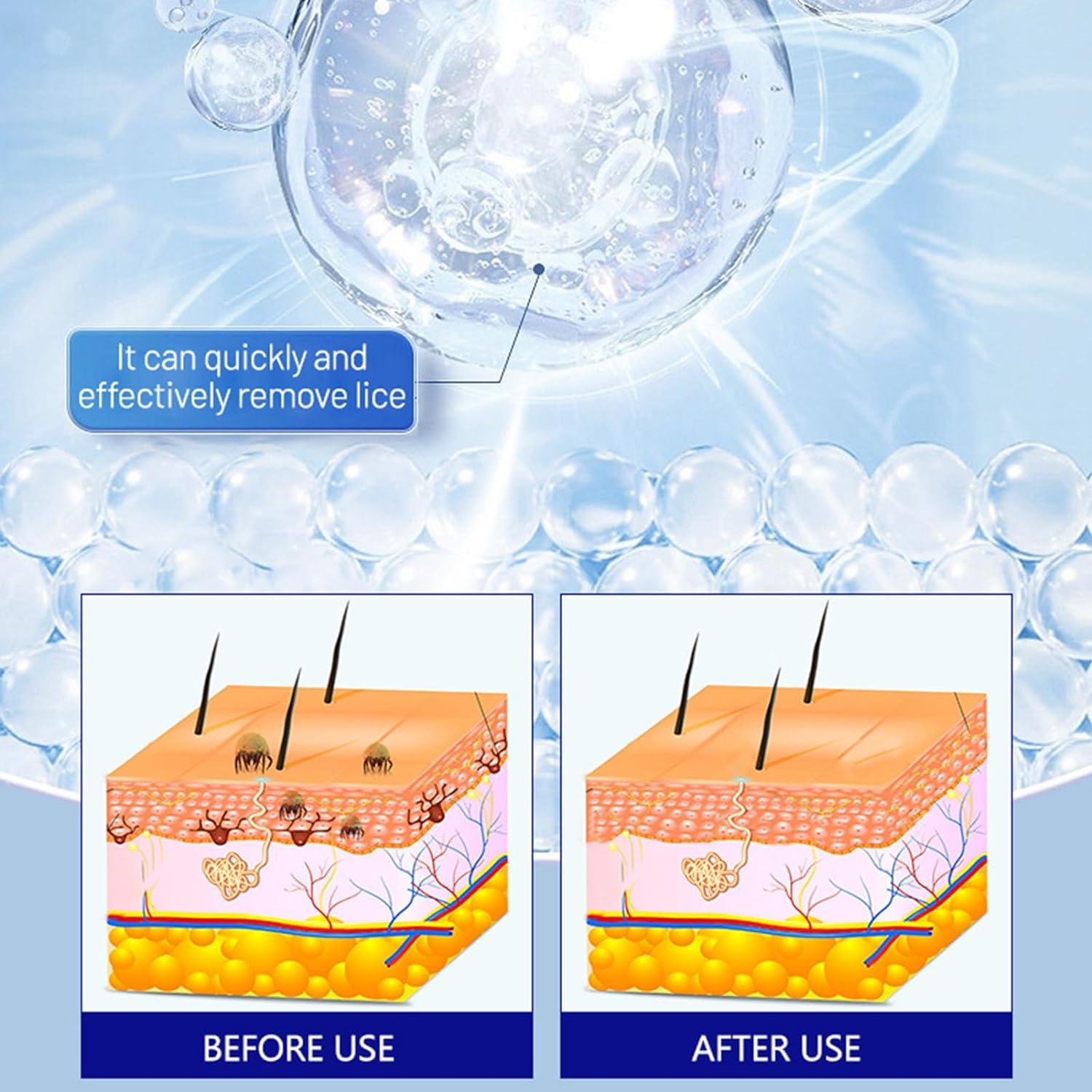 Head Lice Shampoo Lice Remover Shampoo Bar with Peppermint Oil Oil ...