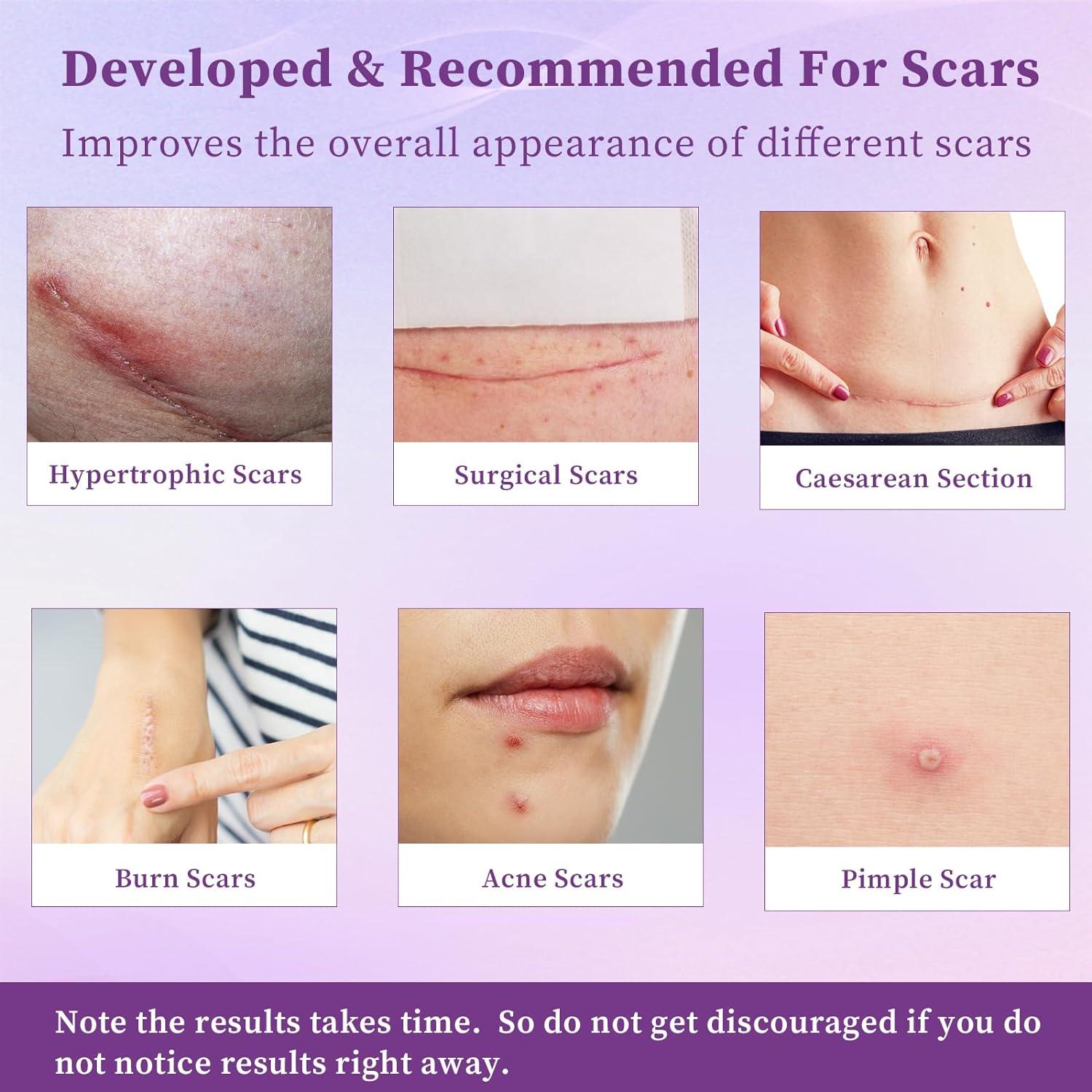 Silicone Scar Removal Tape - Fast Acting Soft Strips for Surgery ...