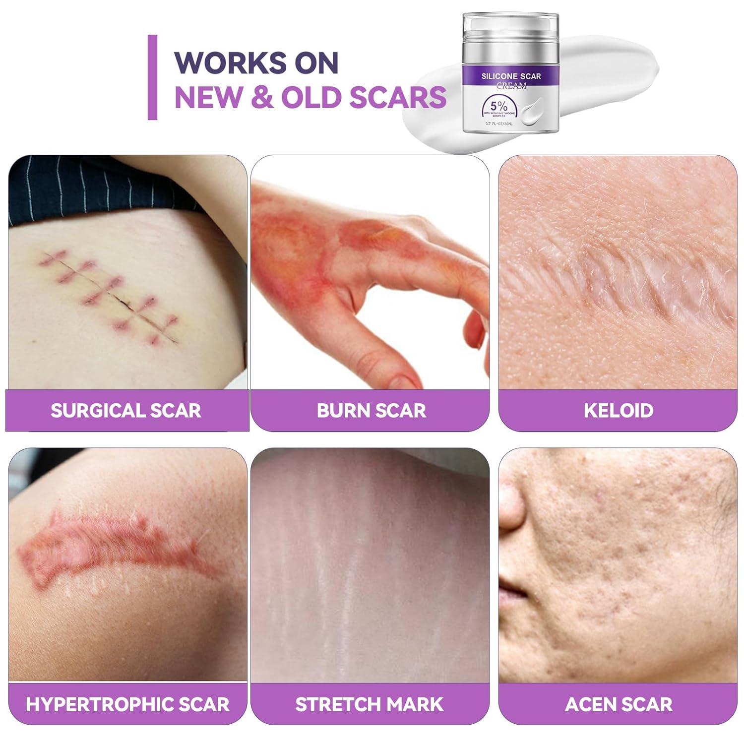 BAUTVAS Advanced Scar Cream, Silicone Scar Gel car Removal Cream for ...