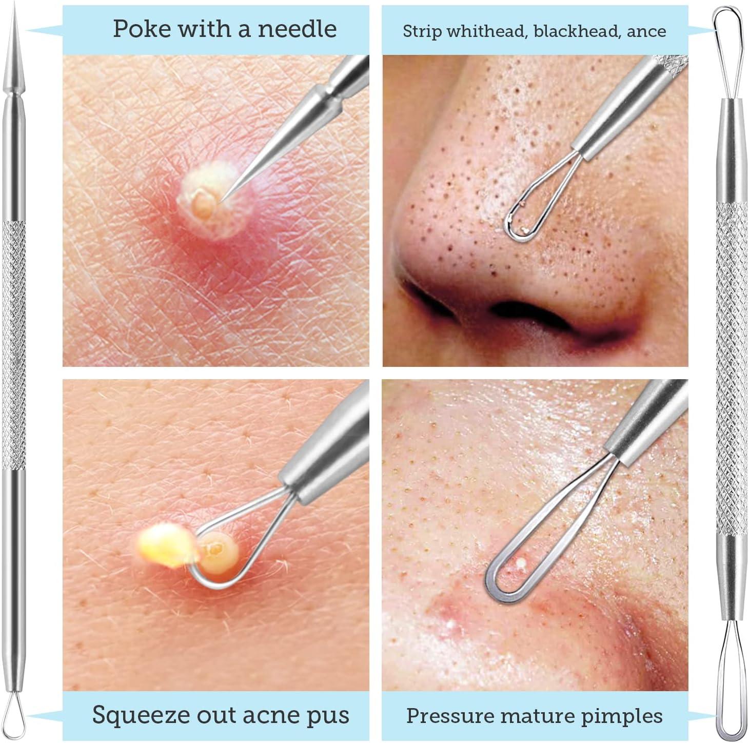 blackhead extraction tool