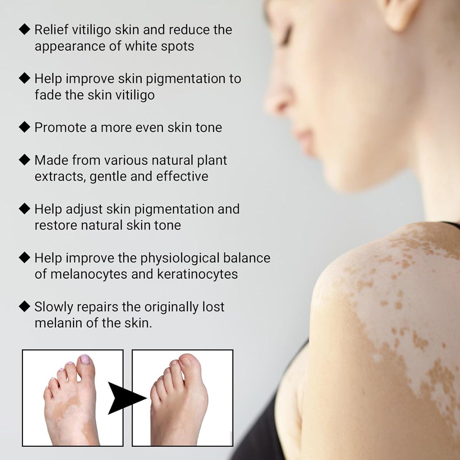 Vitiligo Fix Revitalize Elixir Cream | Psoriasis Relief | Moisturizer ...