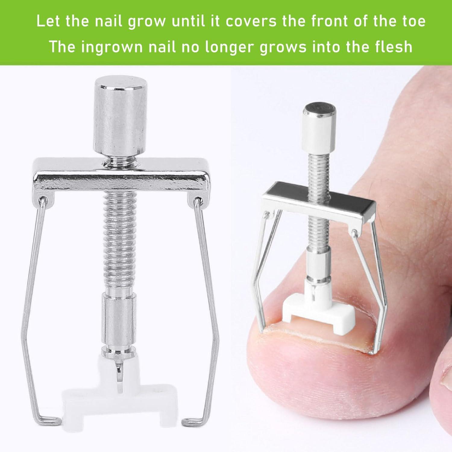 Ingrown Toenail Lifter Tool Set Reduce Pain Swelling Stainless Steel ...