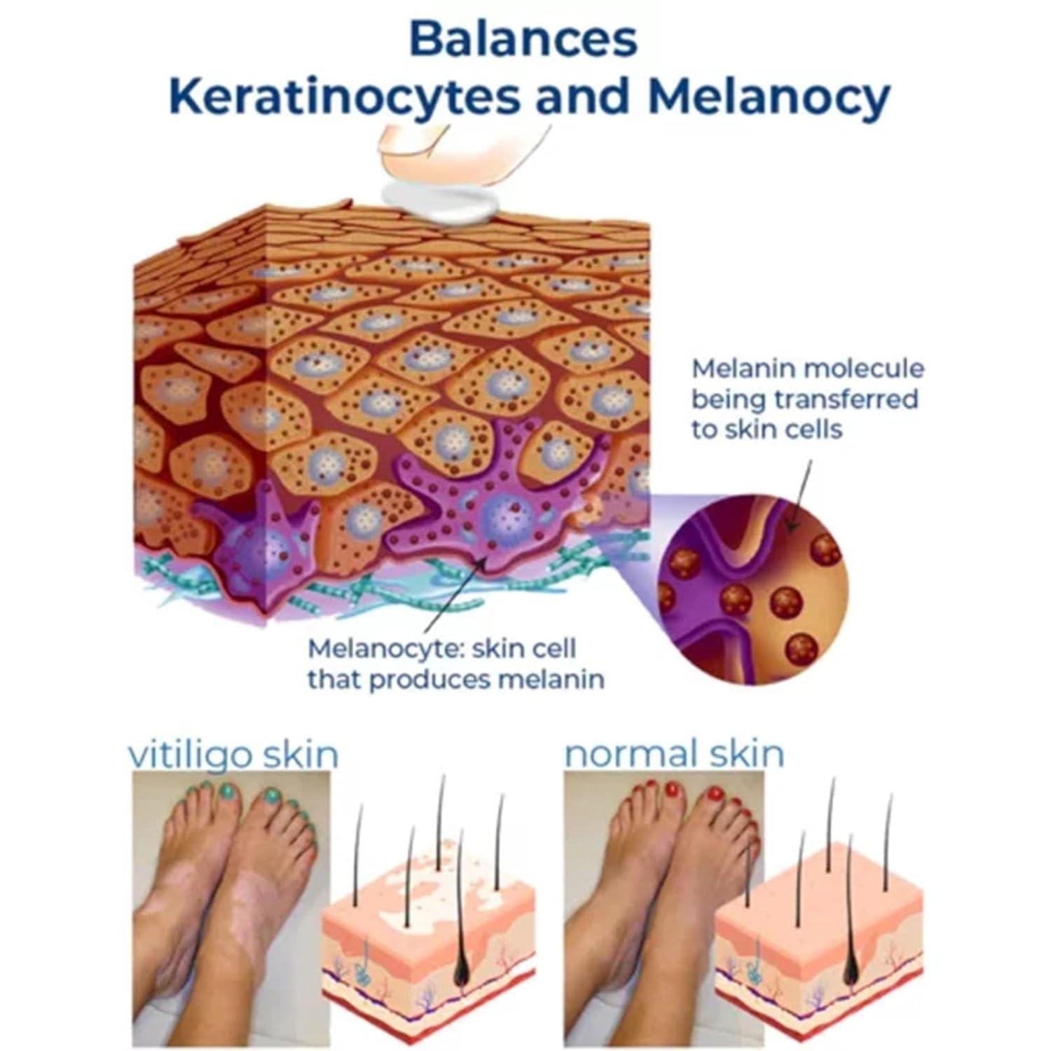 Vitiligo Cream Vitiligo Therapy Cream White Spot Cream Pigmentation ...