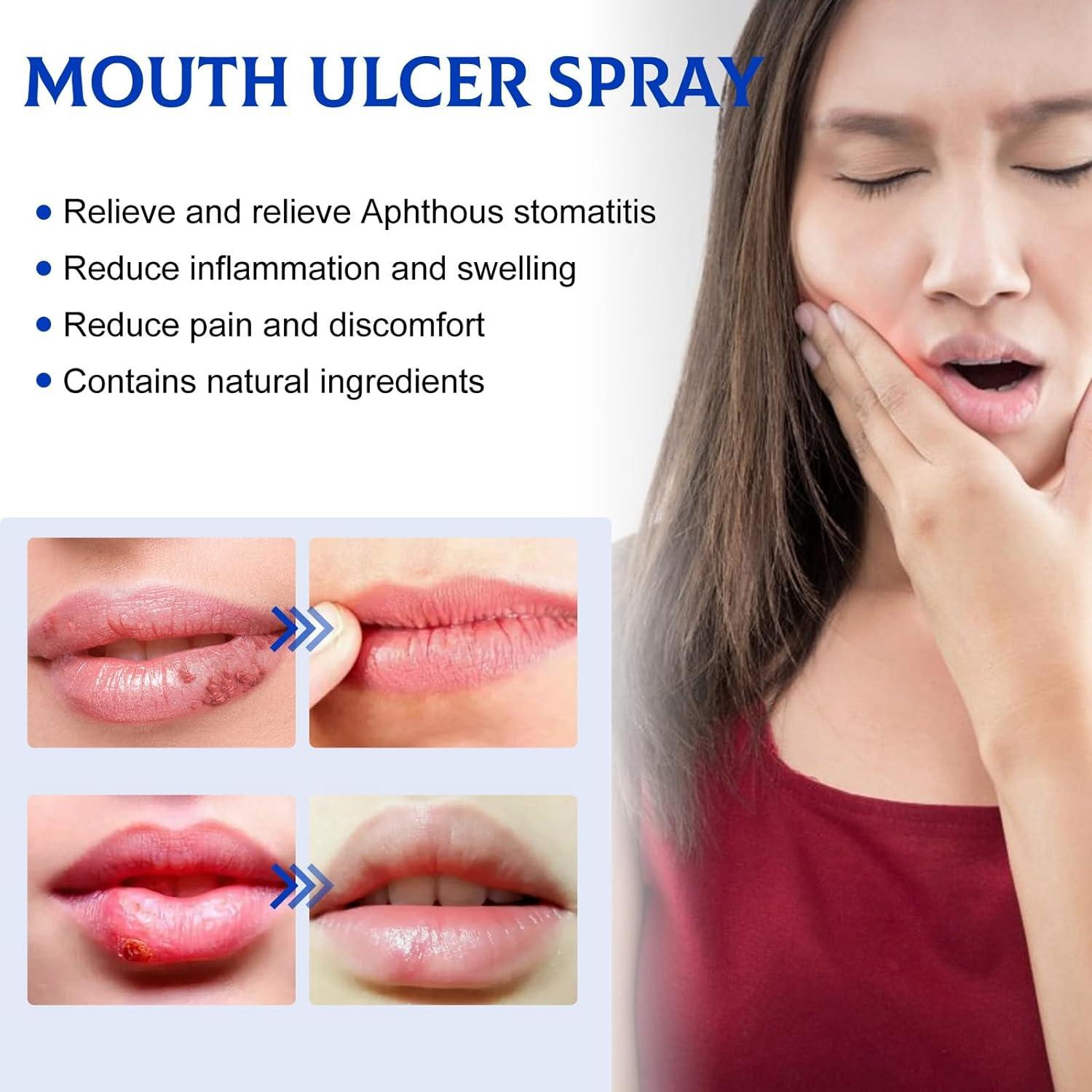 Mouth Ulcer Spray Ulcer Breath Sprays Mouth Ulcer Treatment Spray Ulcer ...