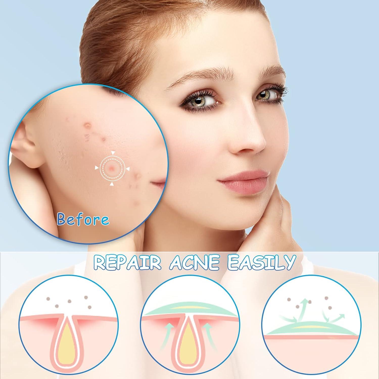 252 Invisible Hydrocolloid Acne Pimple Patches - Effective Anti-Acne ...