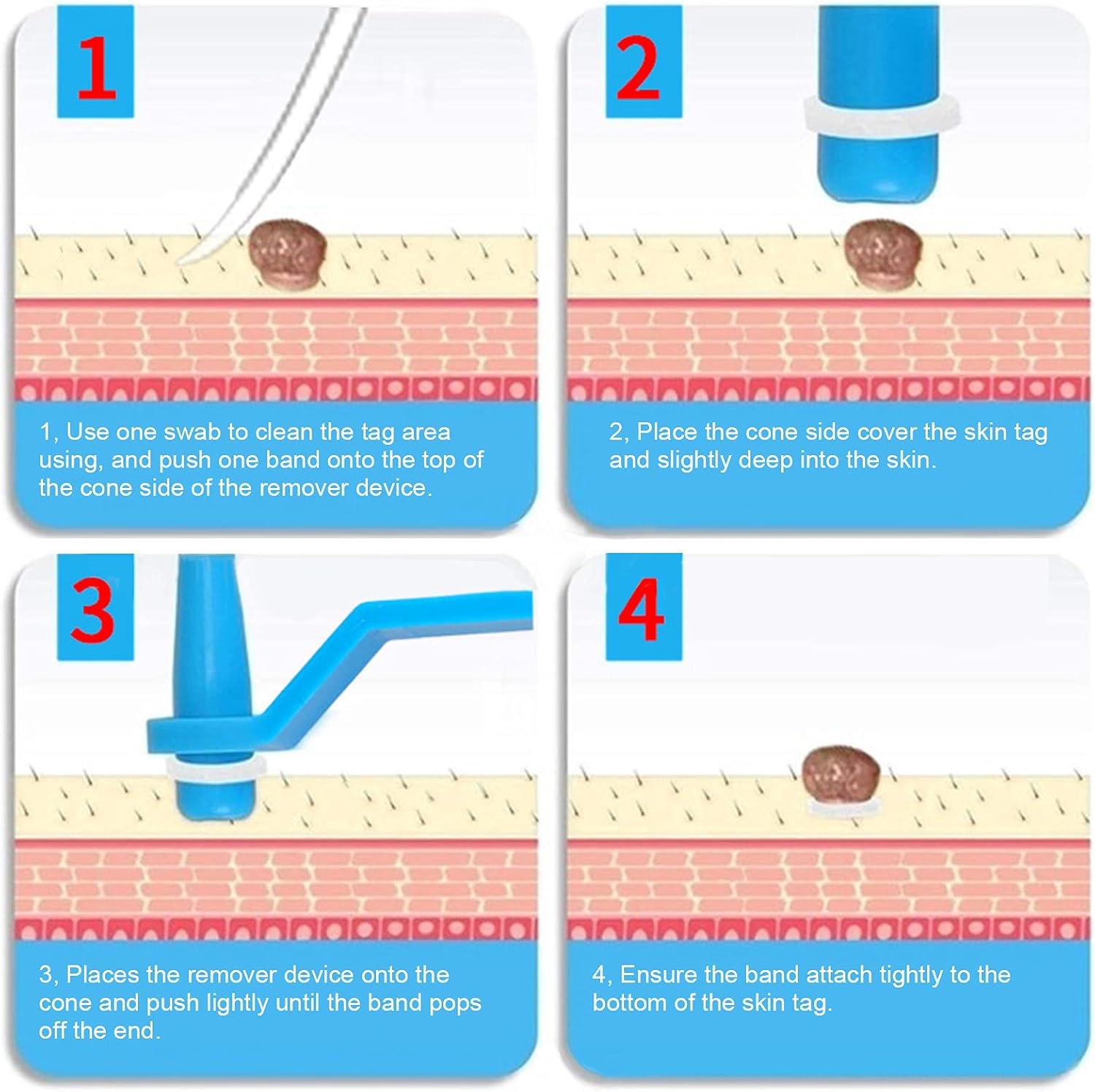 30Pcs Skin Tag Removal Rubber Bands Kit - Safe & Easy Non-Toxic Skin ...