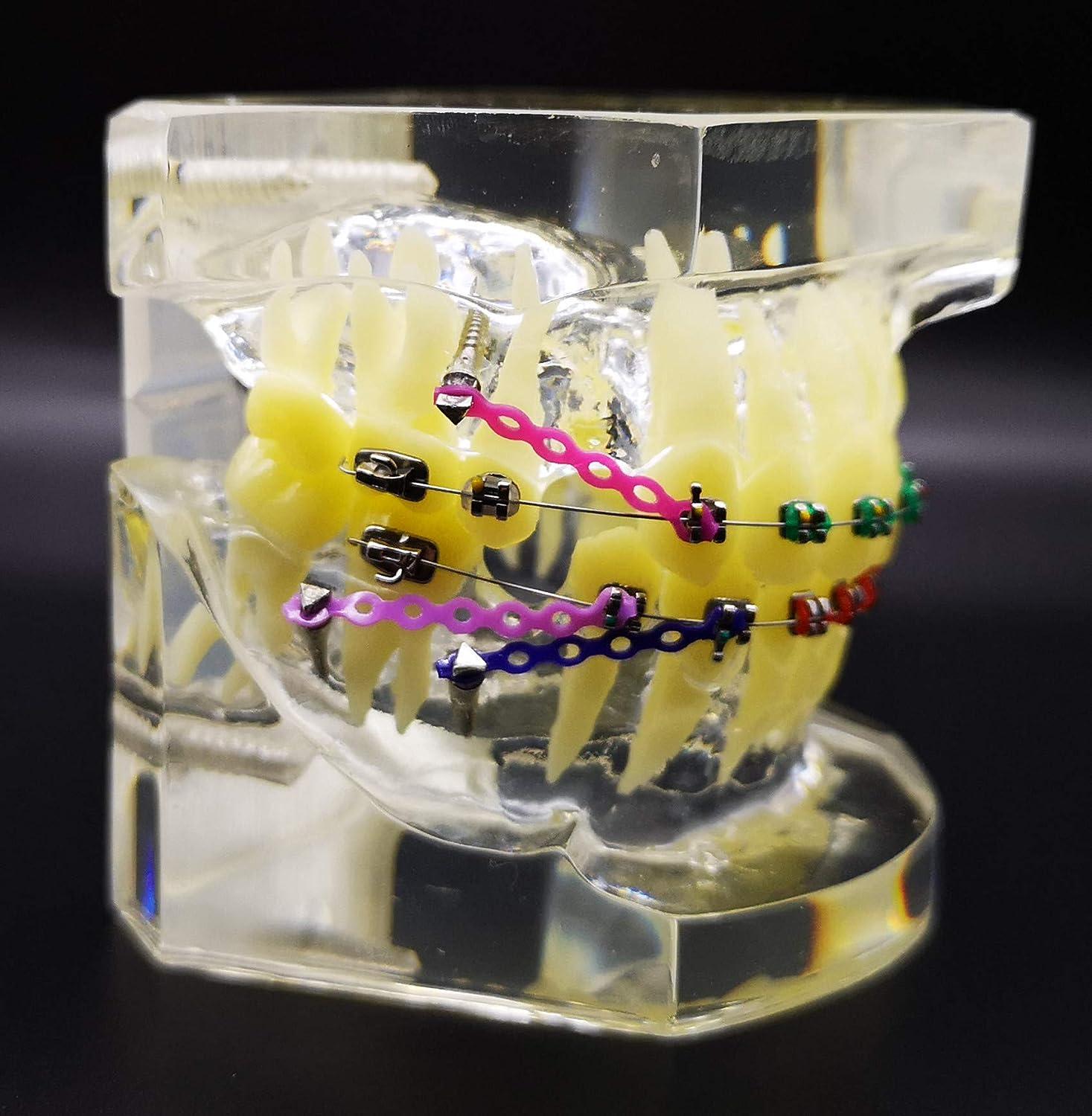 Dental Typodont Orthodontic Teeth Model with Metal Braces & Ligature ...