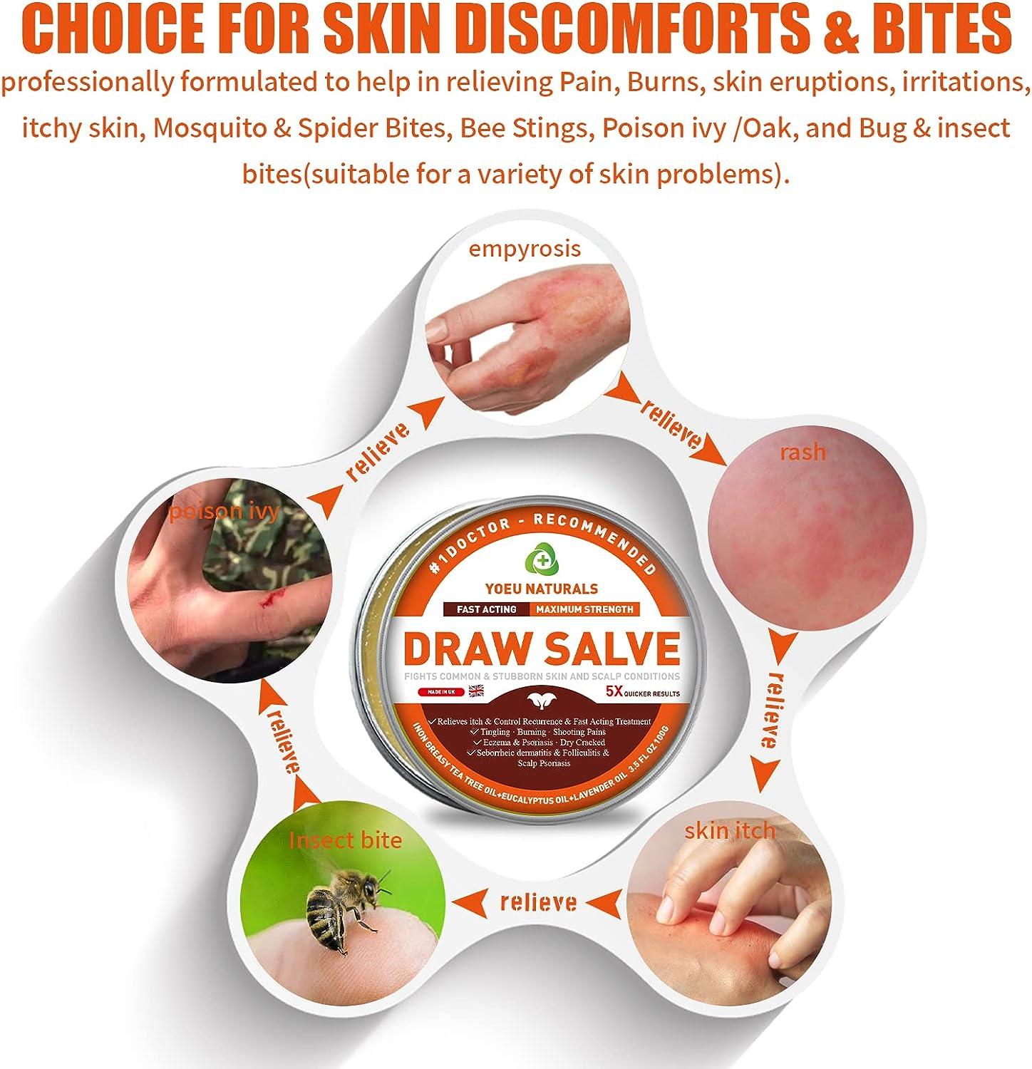 Multi-Purpose Skin Relief Cream | Treat Heat Rash, Jock Itch, Tinea ...