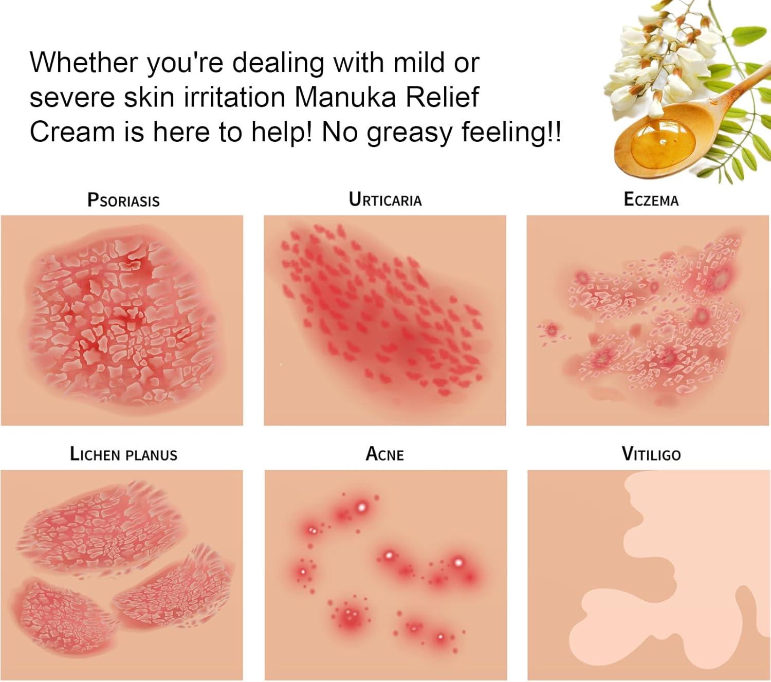 Buy 1 Pack Manuka Honey Eczema Cream with Tea Tree Oil | Soothing ...