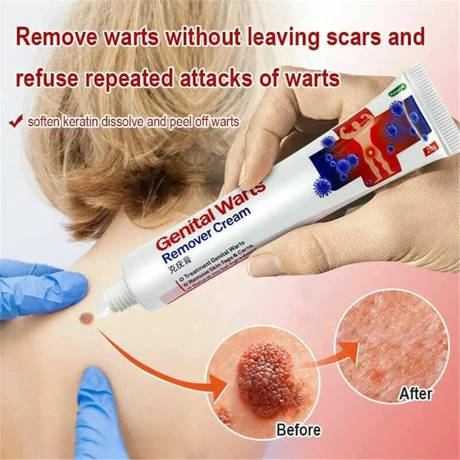 2023 Herpes Remover & Wart Ointment - Genital & Vulva Treatment (20g 2 ...