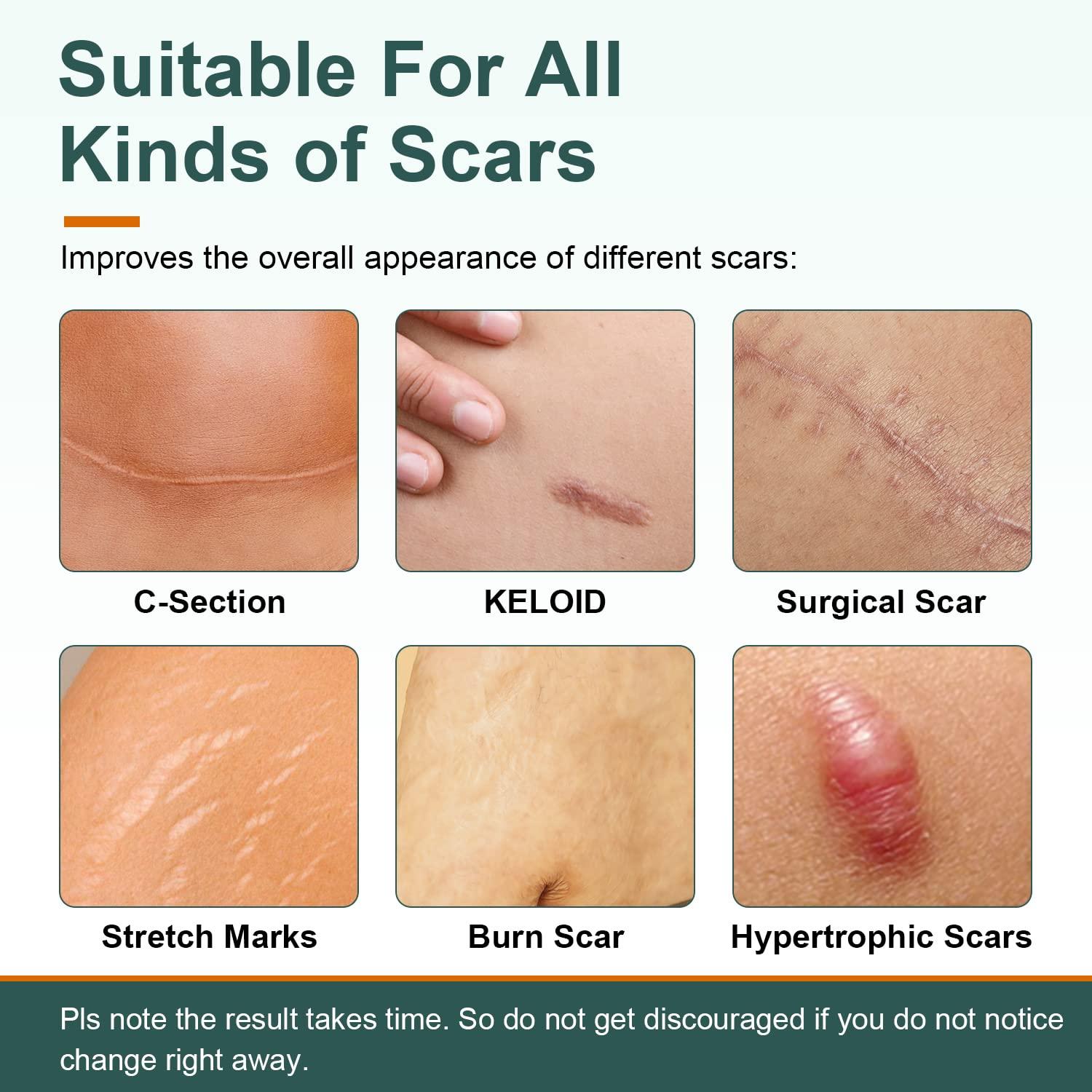 FUNNIR Silicone Scar Sheets Tape Strips - Heal Keloid & Surgery Scars ...