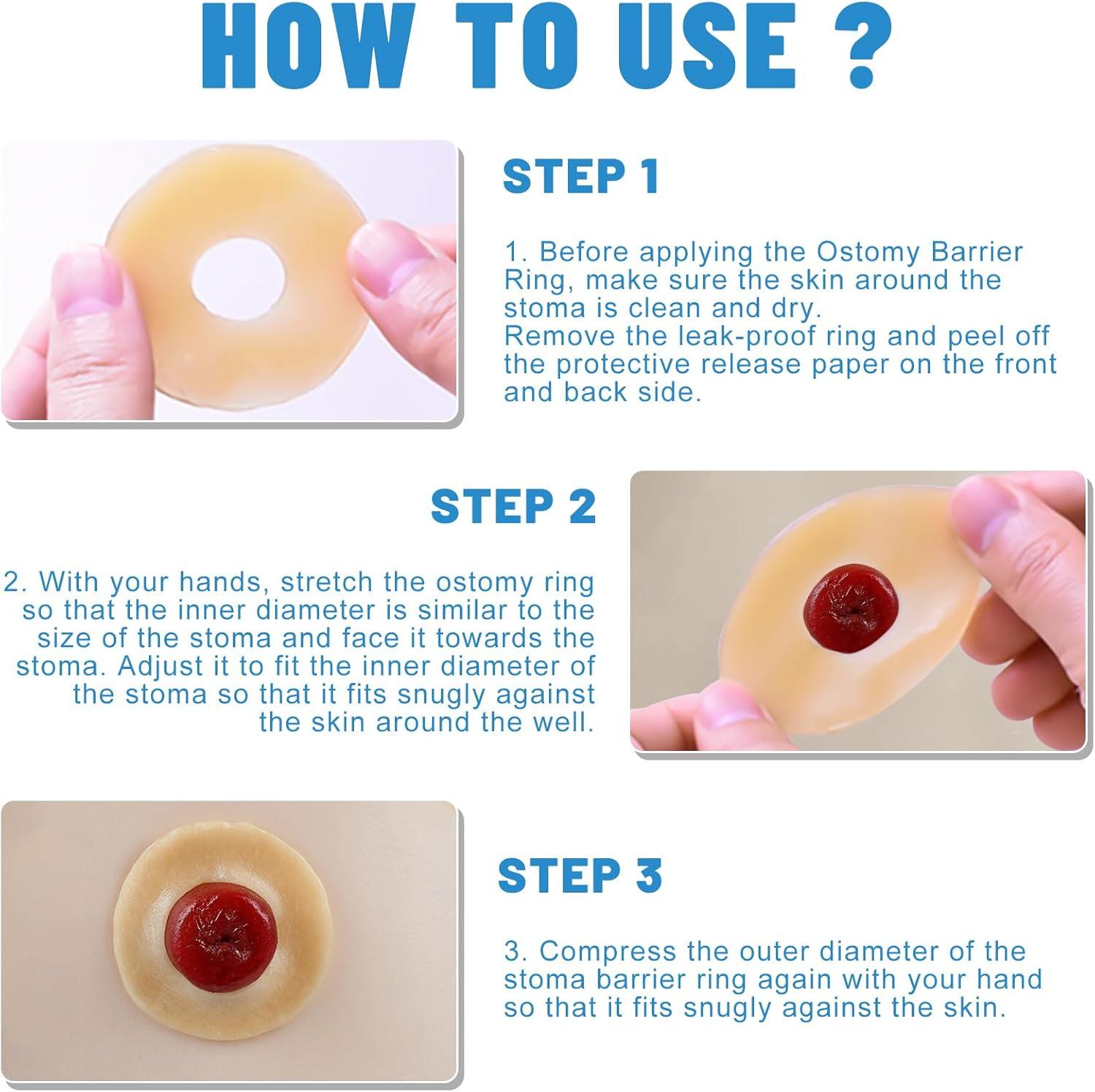Ostomy Barrier Rings - Moldable Hydrocolloid Ring Supplies for ...