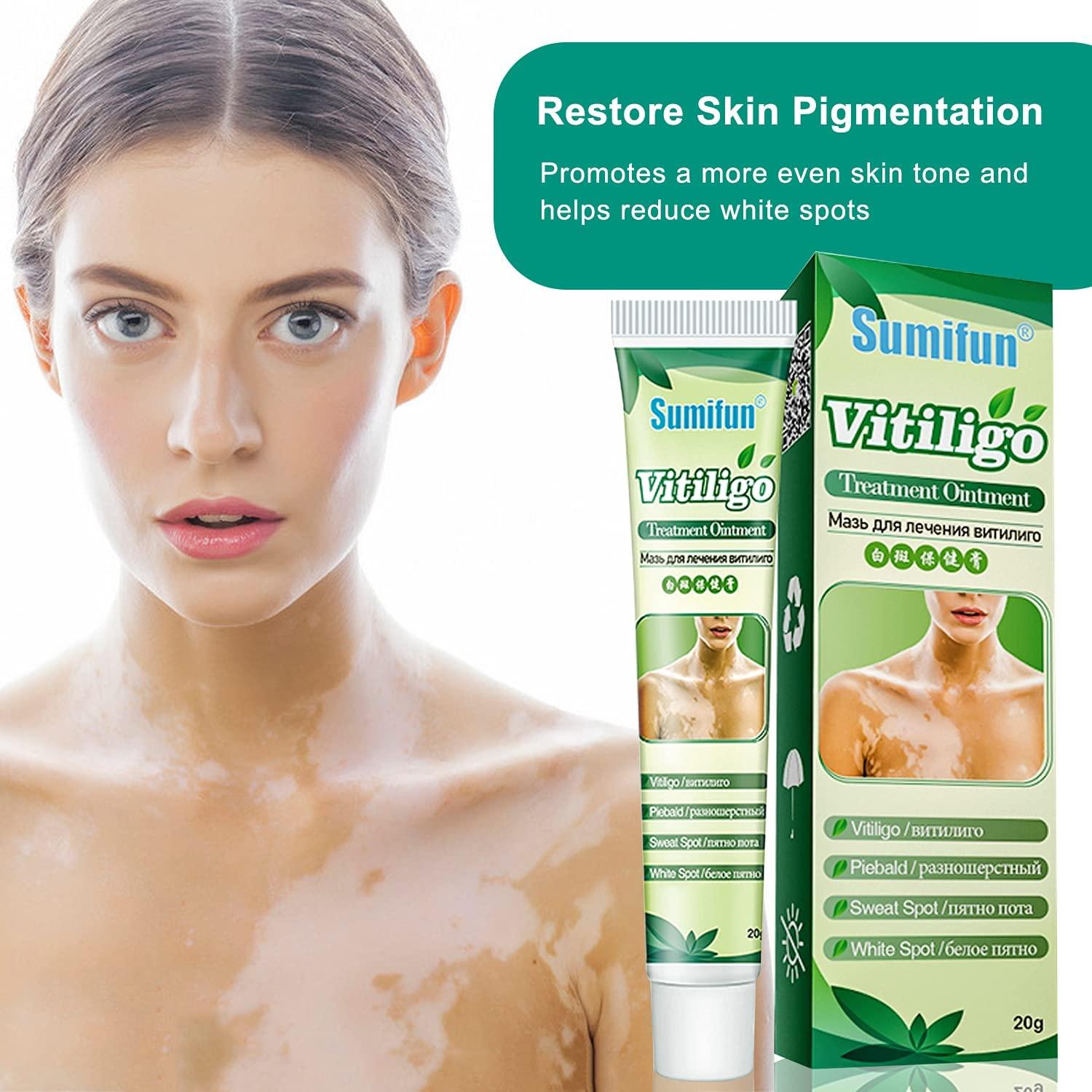 Sumifun Vitiligo Cream - Skin Care for Vitiligo, Psoriasis ...