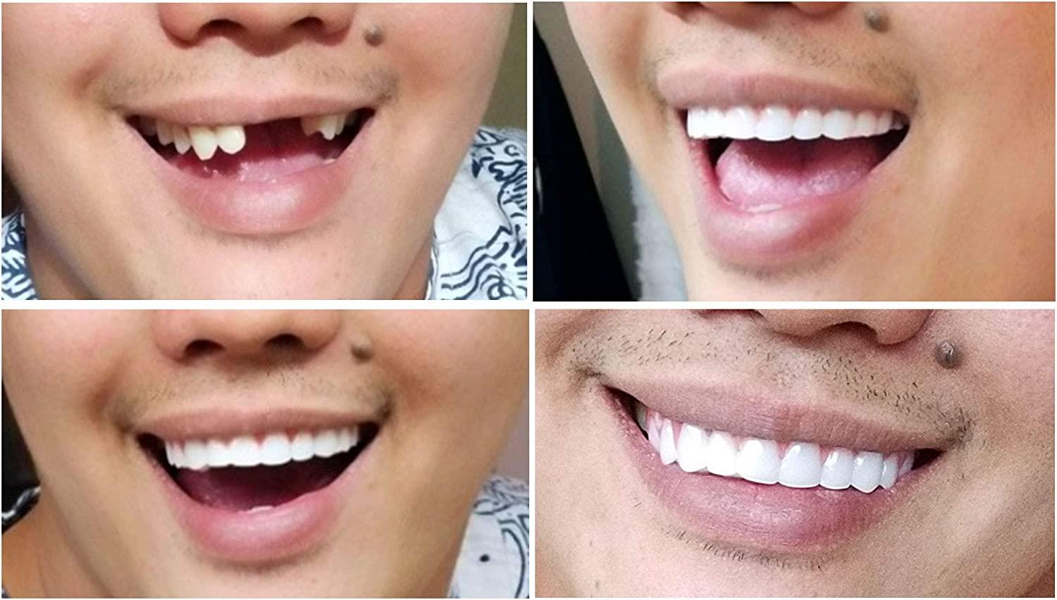 Instant Smile Comfort Fit Flex - Bright White Upper Veneer Cosmetic ...