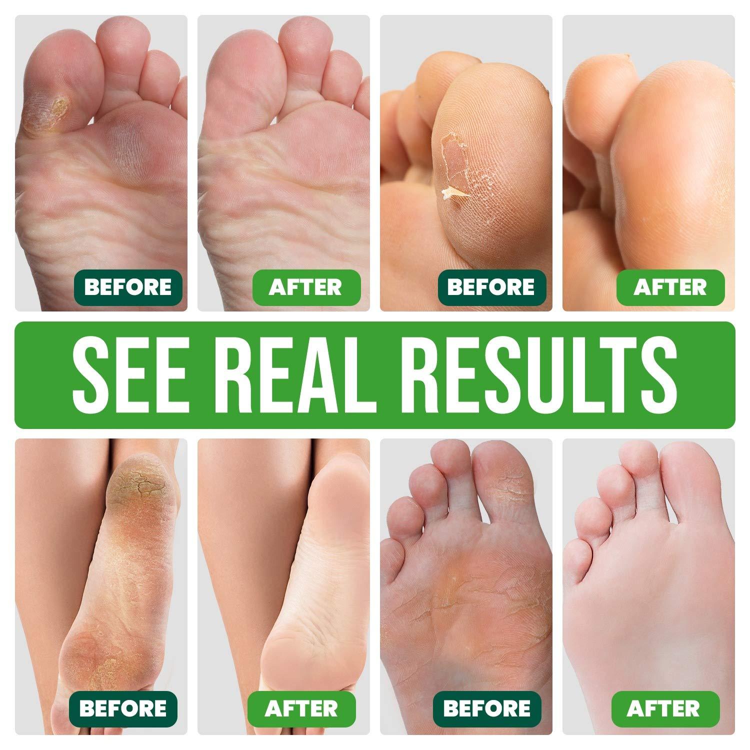 VeraCare Lavender Foot Peel Mask - 2 Pairs - Exfoliating & Moisturizing ...