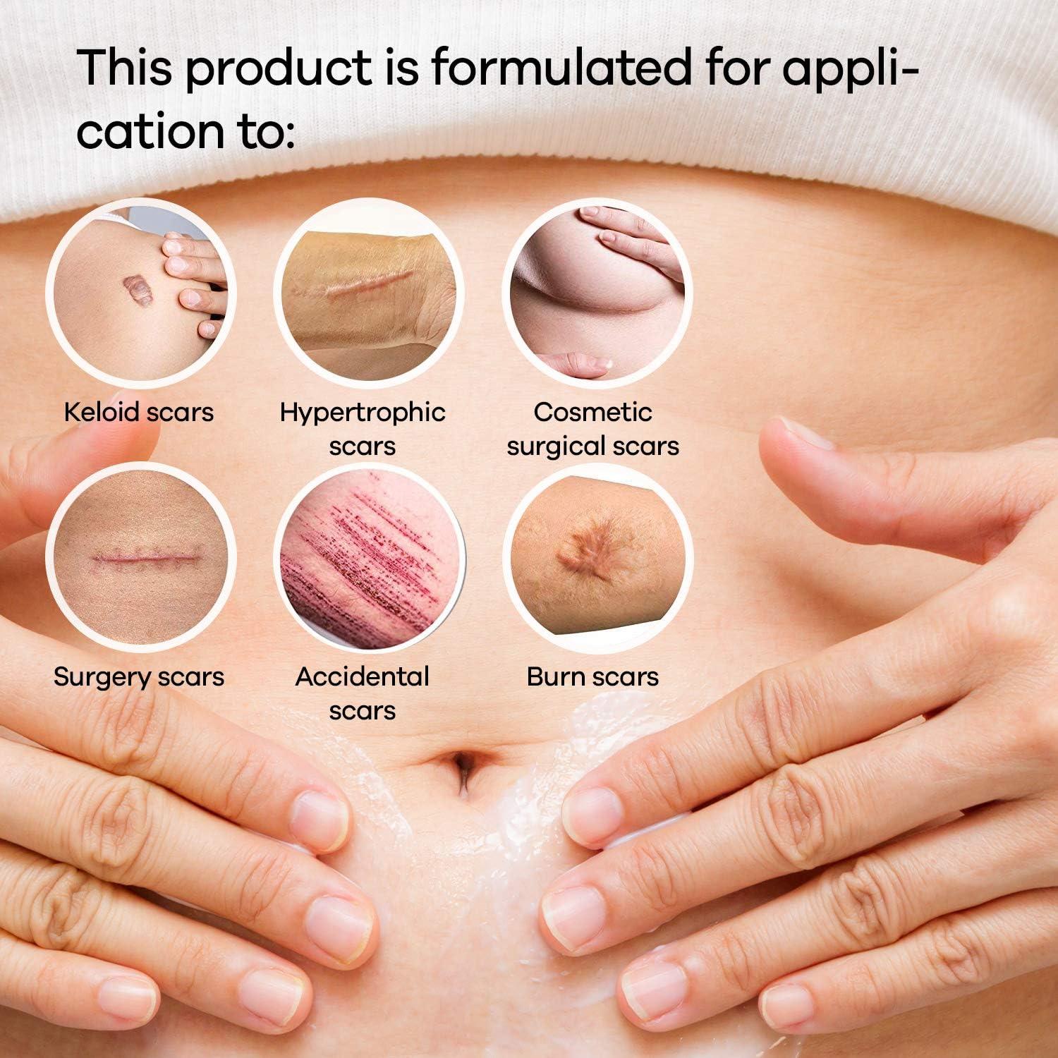 Wewell Medical-Grade Silicone Scar Gel | Advanced Treatment for Old ...