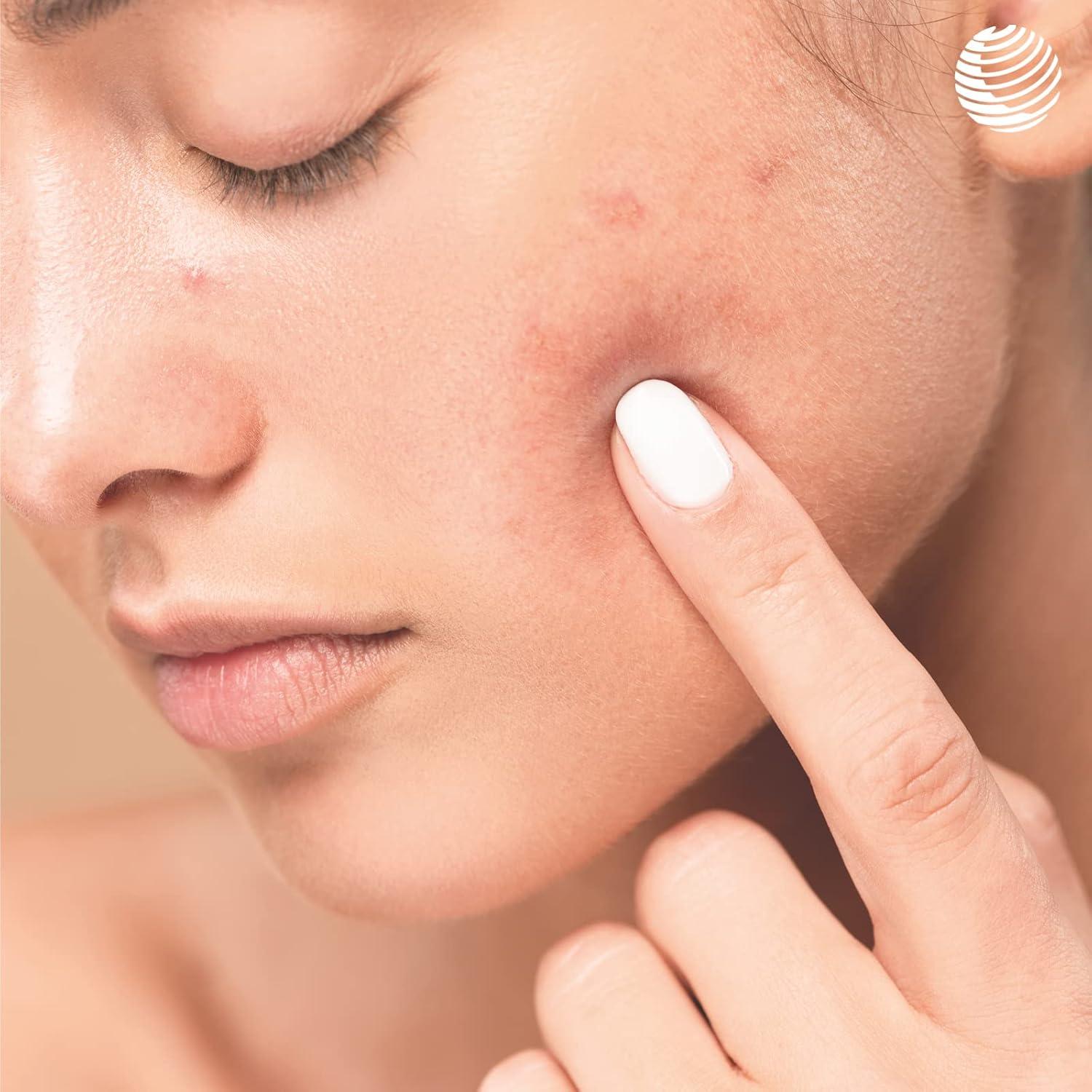 Dr. Rimpler Zinc Ointment for Pimples | Spotless SOS Anti-Pimple Cream ...