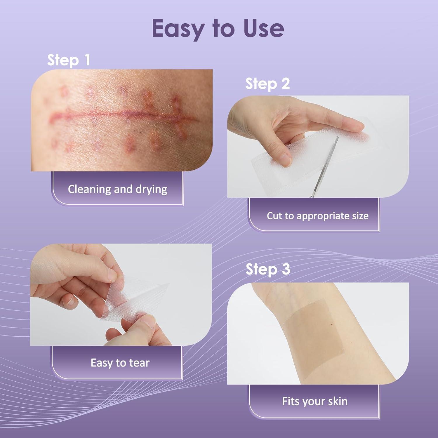 Silicone Scar Sheets Roll 1.6x120 - Ultra-Thin & Soft Medical Grade ...
