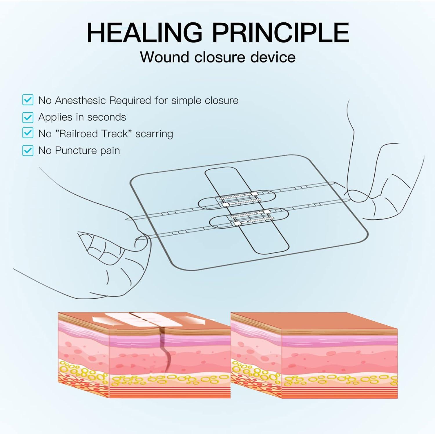 Zip Stitch Laceration Repair - Emergency Wound Closure Device (Pack of ...