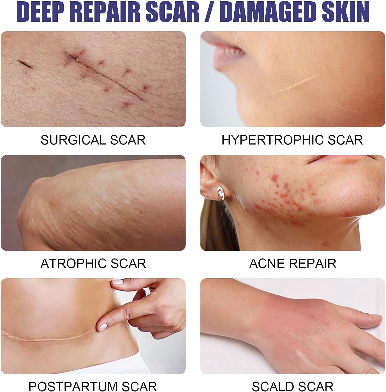 Silicone Scar Tape Roll - Professional Reusable Sheets for Surgical ...