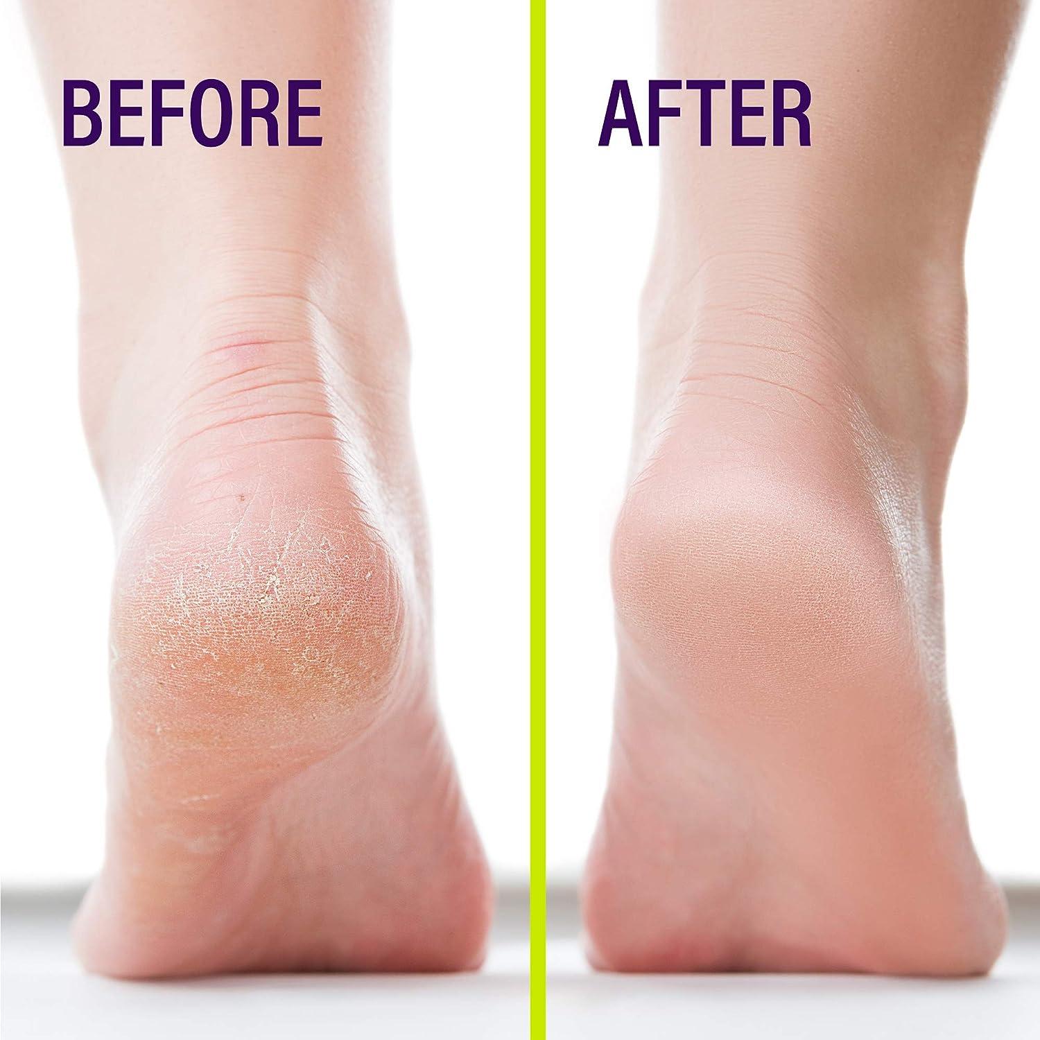 Heel-Seal Liquid Skin Protectant for Cracked Heels - Foot Repair & Care ...