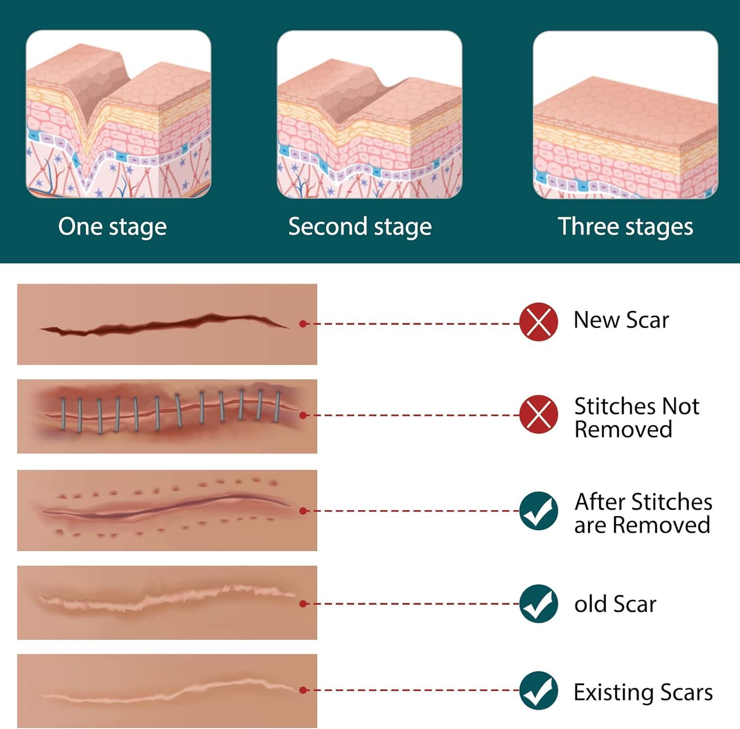 Silicone Scar Sheets Reusable Medical Grade Thinken Scar Sheet for C ...