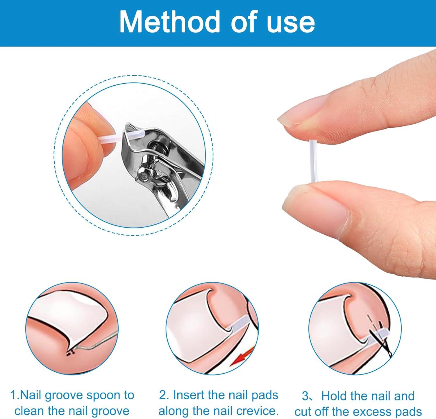 Ingrown Toenails Set Toenail Correction Patch Nail Clip Toenails ...