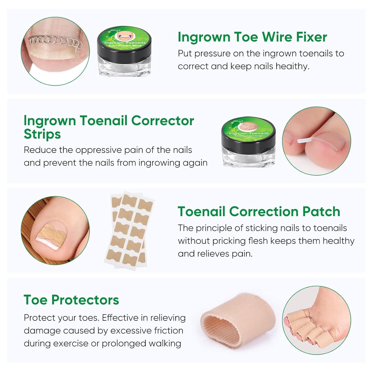 Professional Ingrown Toenail Treatment Kit | 50 PCS Corrector Patches ...