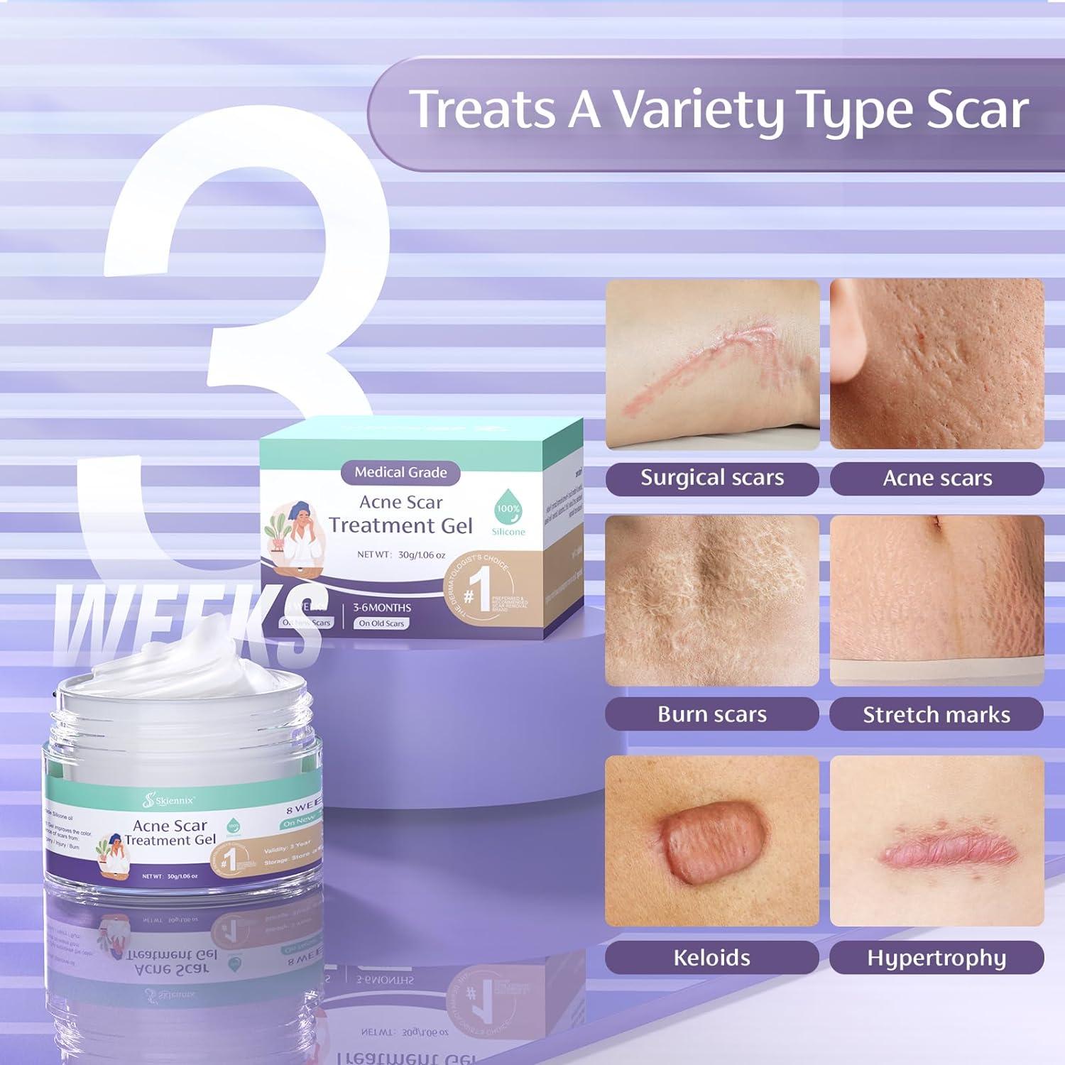 30g Skiennix Acne Scar Removal Cream - Medical Grade Advanced Gel for Face Scars | Treats Old ...
