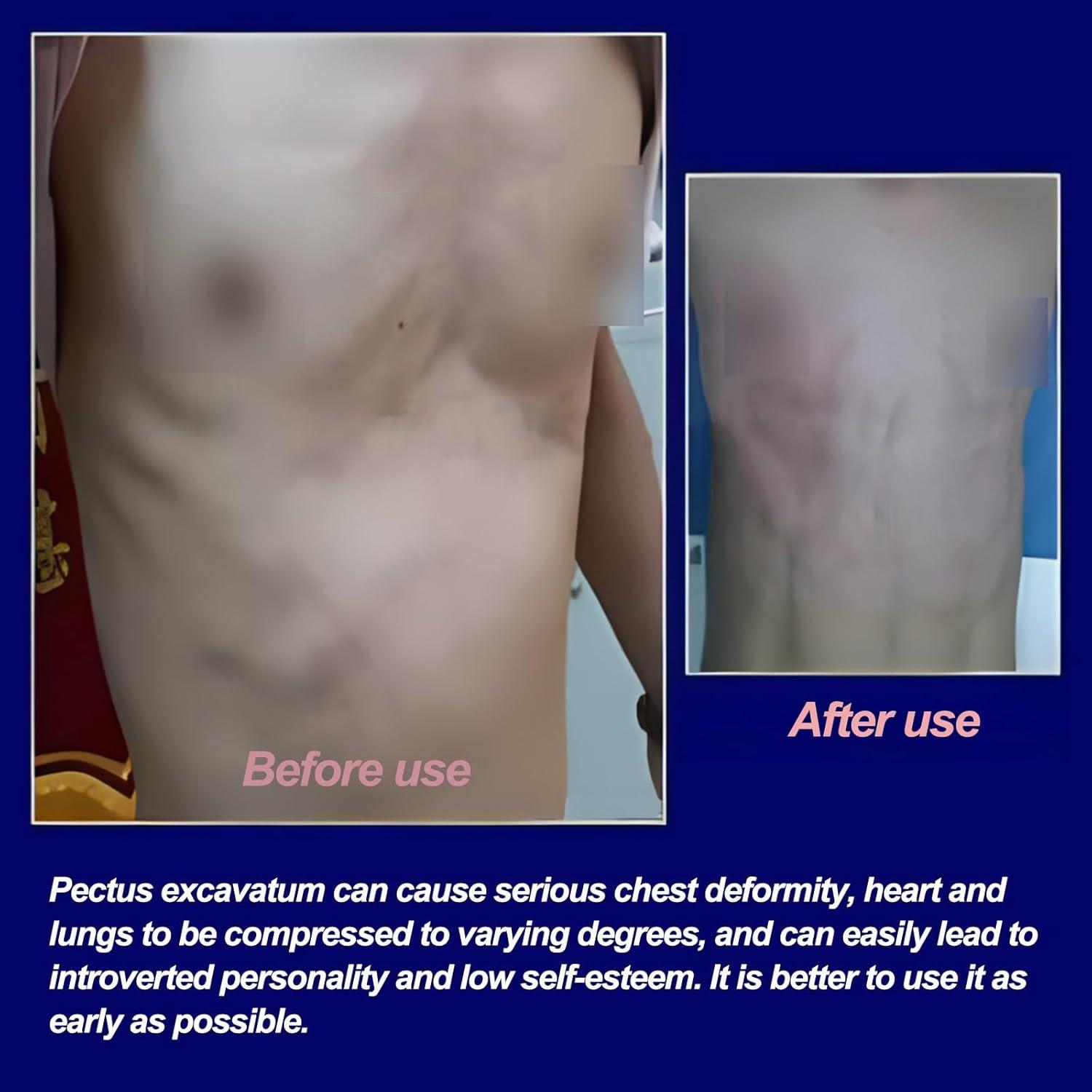 Pectus Excavatum Orthosis Brace-Vacuum Bell Pectus Excavatum-Sternal ...