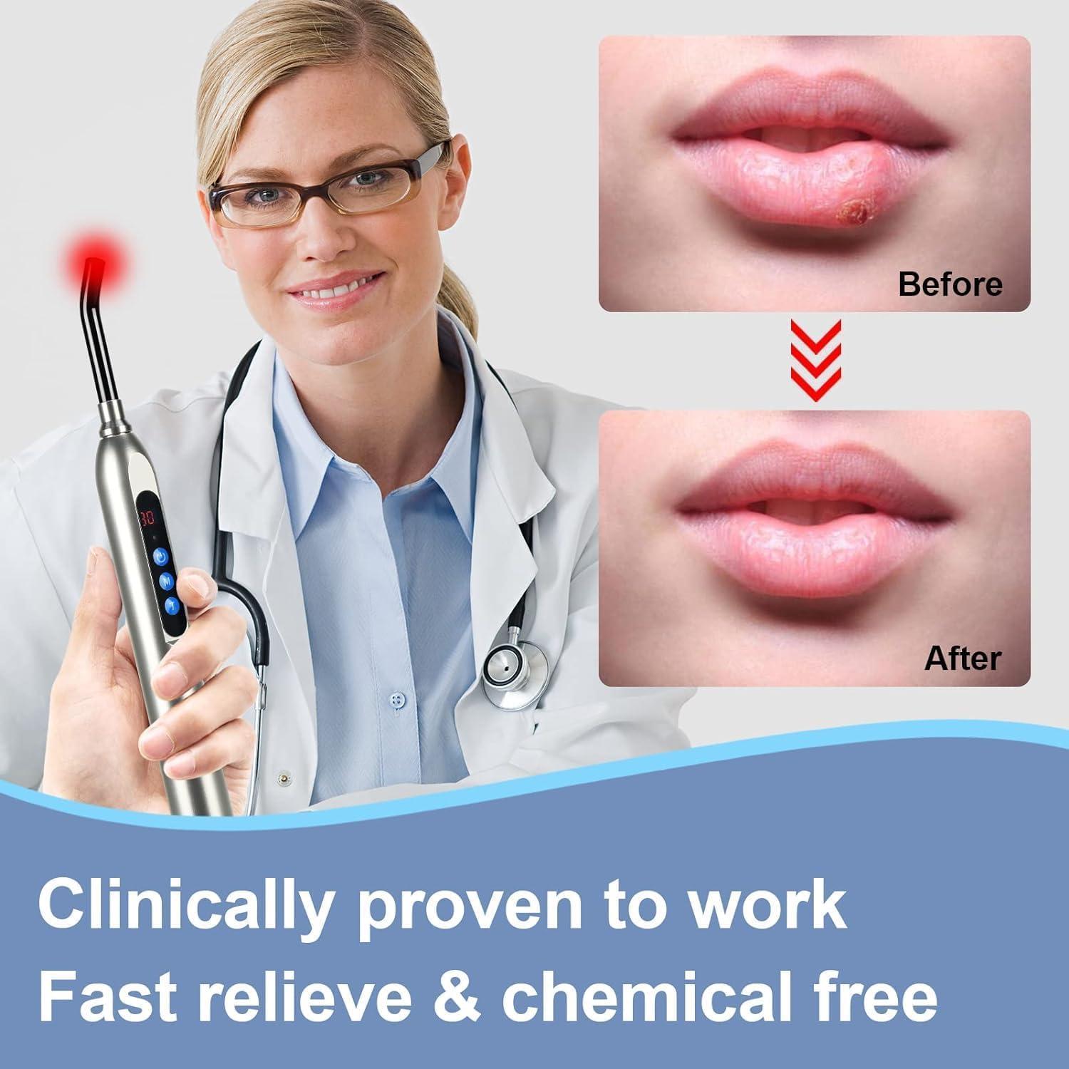 Red Light Therapy Device for Herpes Treatment Cold Sores | Buy Now with ...