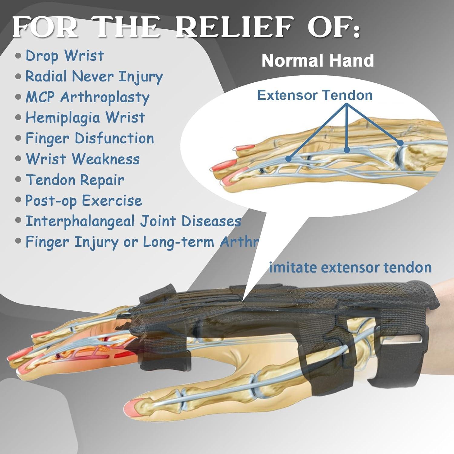 Adjustable Radial Nerve Palsy Splint - Finger Extension Brace for Drop ...