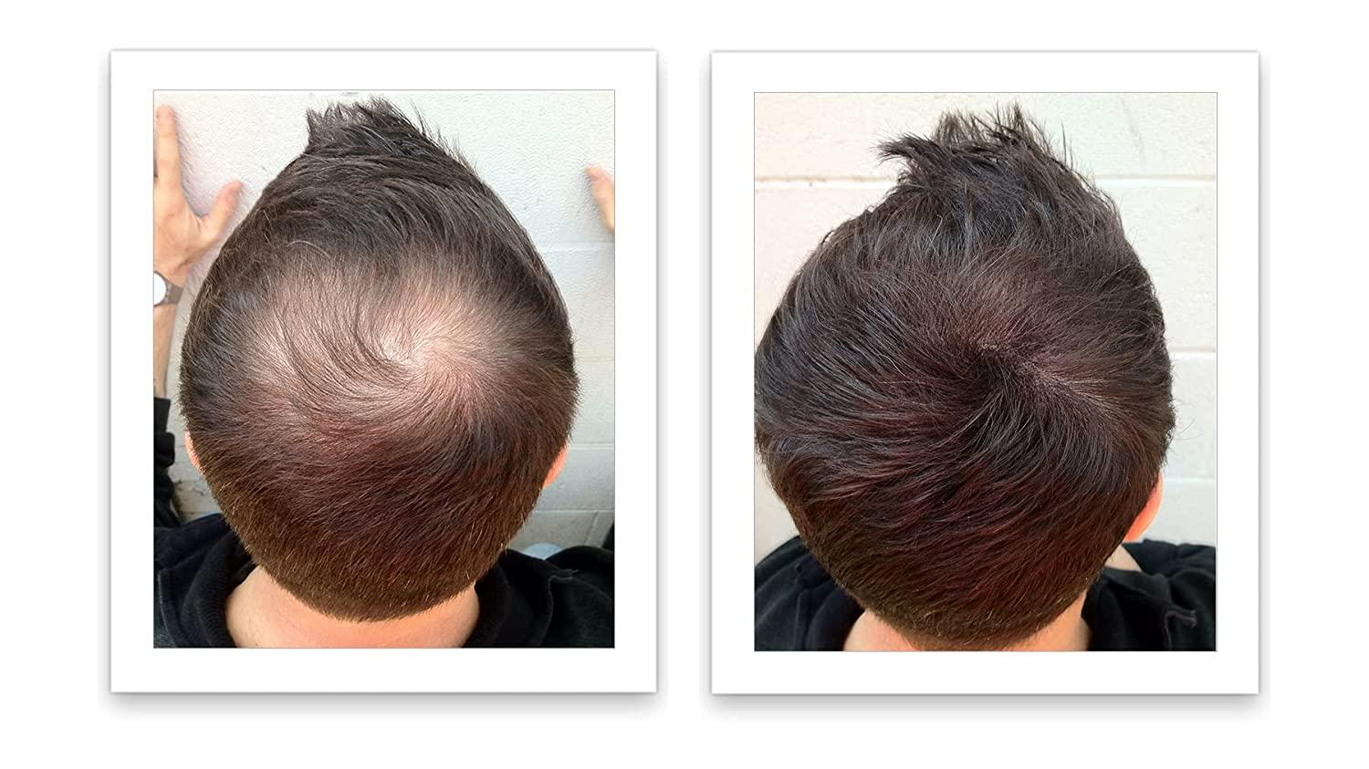 Dark Brown Hair Loss Concealer Trial Size - Cover Bald Spots Instantly ...