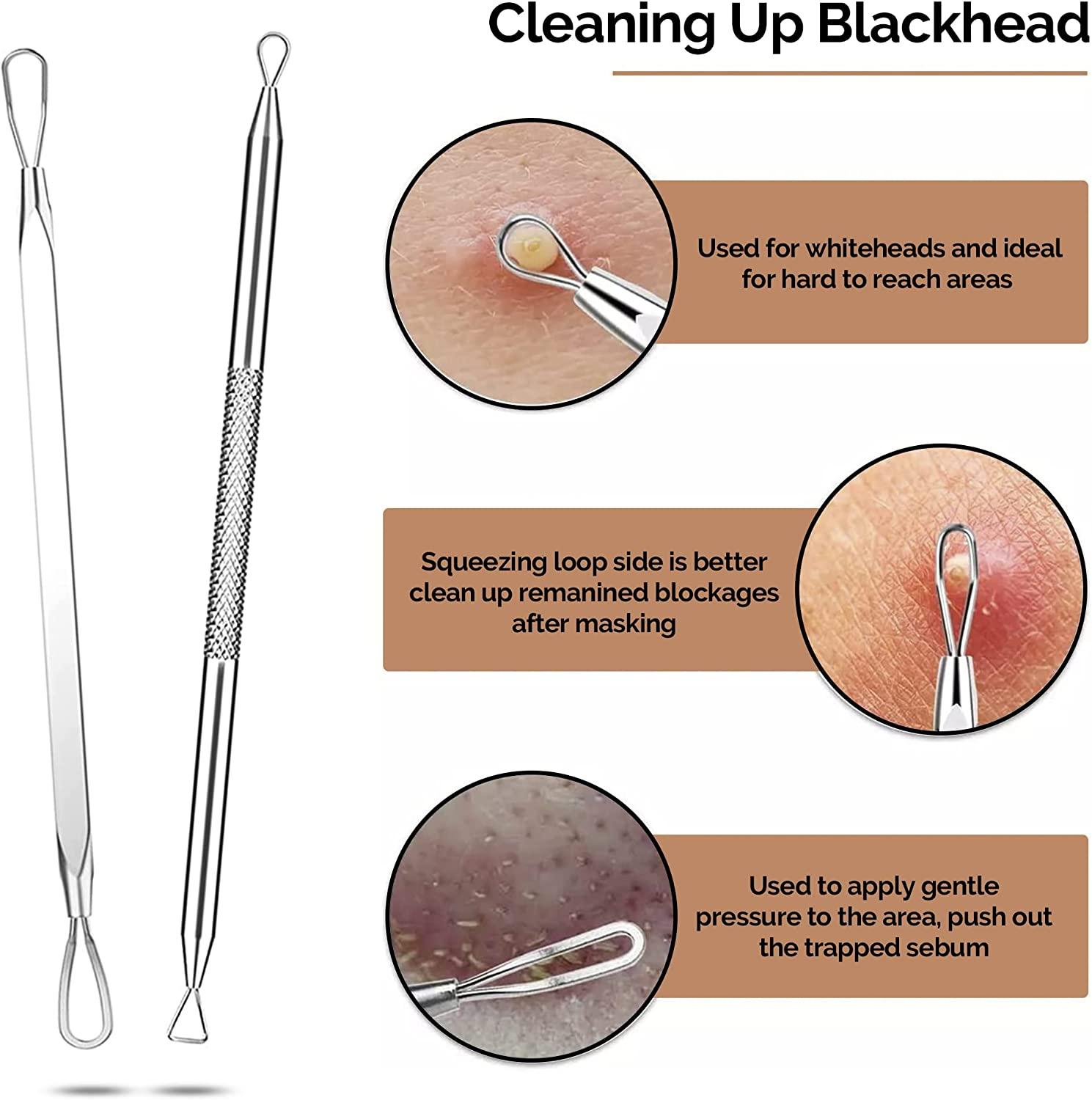 whitehead blackhead extraction