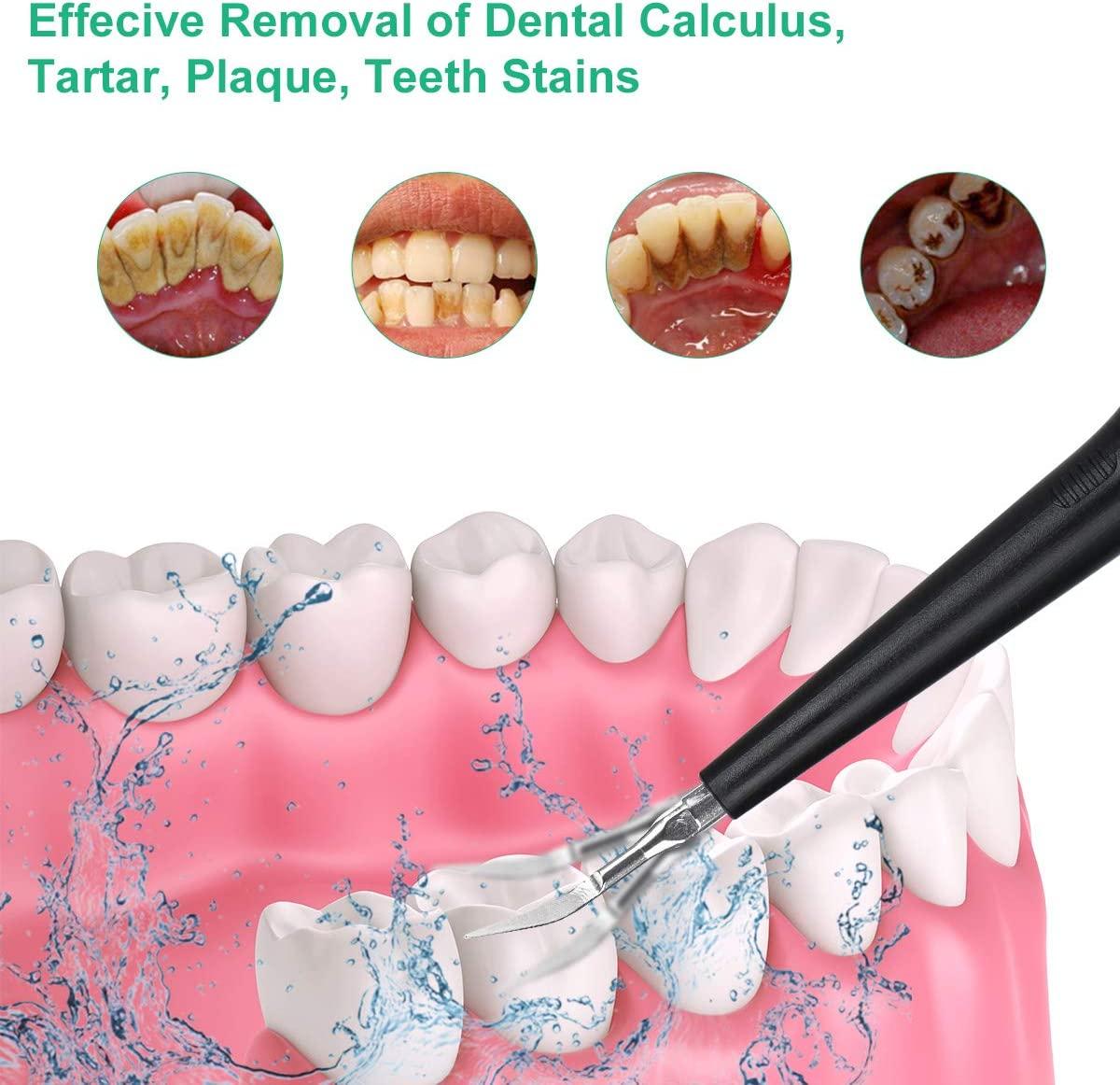 black calculus teeth