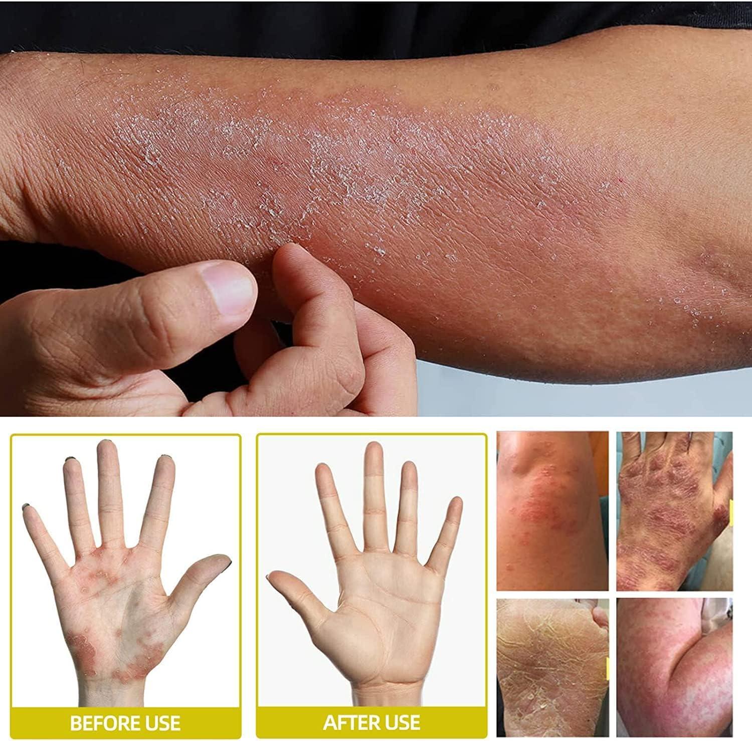 Organic Herbal Tinea Corporis Cream for Skin Relief - 3pcs Set for ...