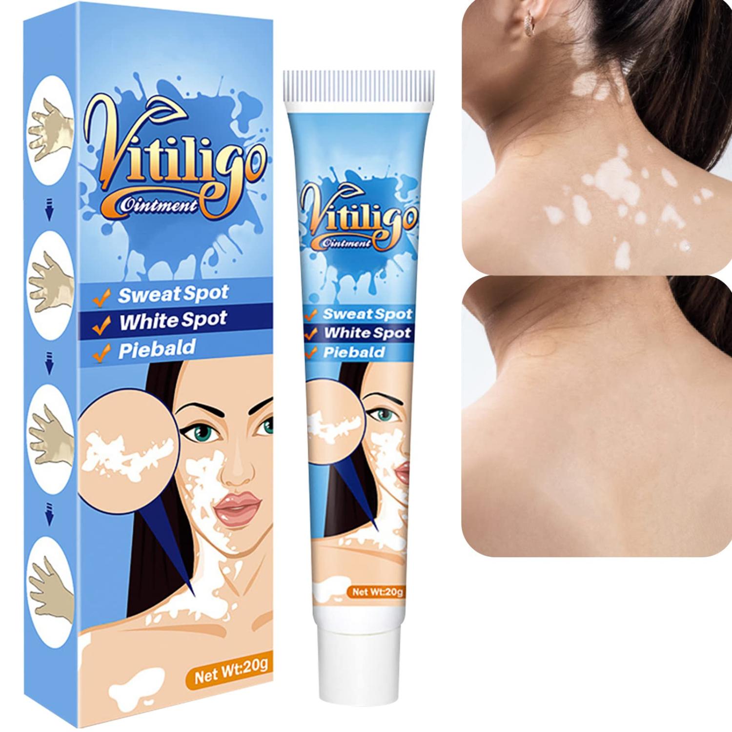 Vitiligo Cream for Skin Treatment and Pigmentation Care | Buy Now with ...