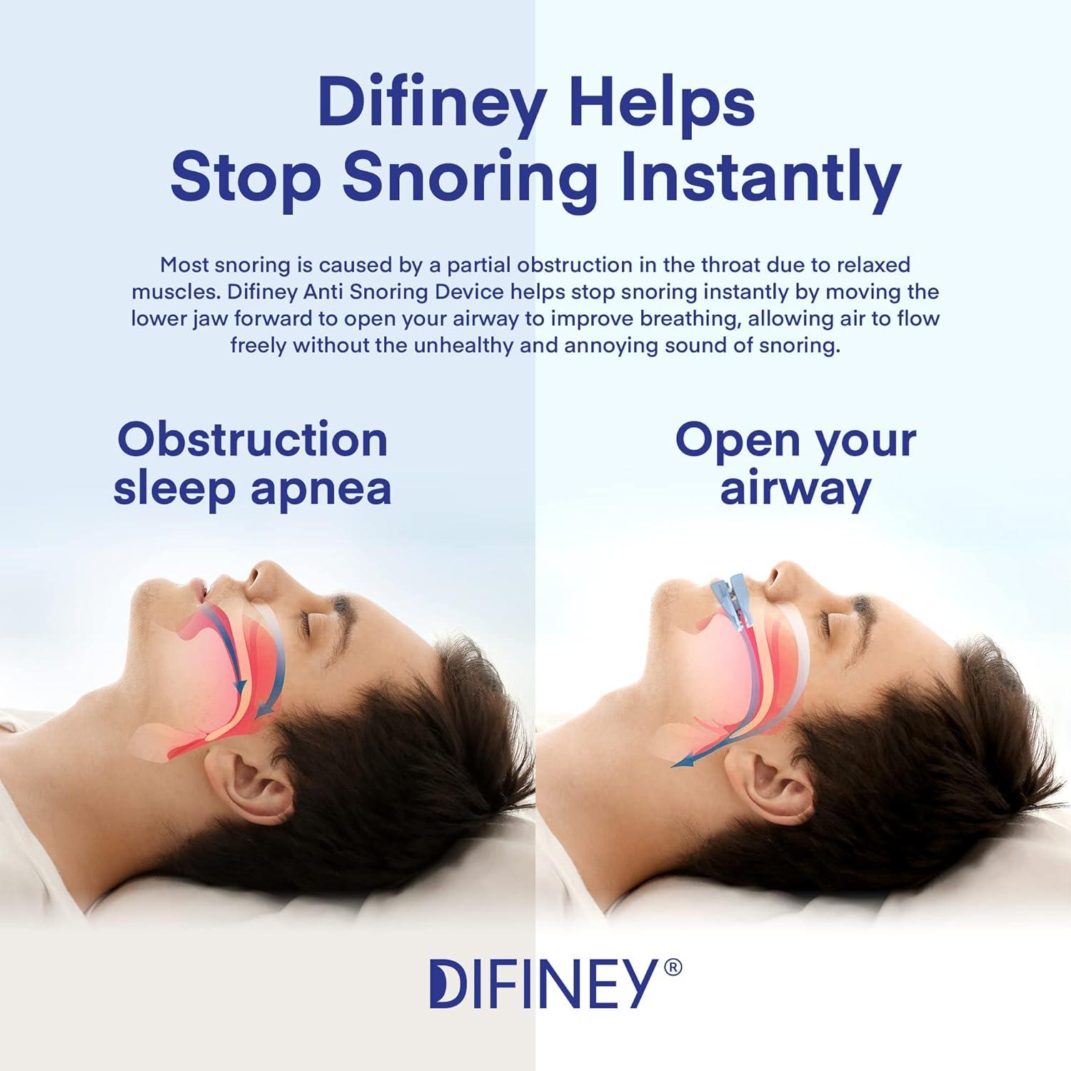 Difiney Anti Snoring Devices - Effective Solution for Men and Women ...
